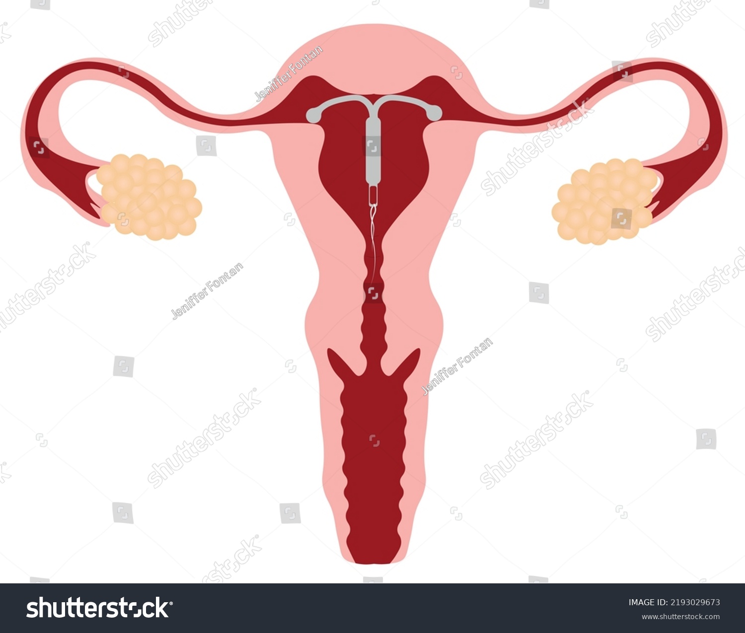 Intrauterine Device Iud Illustration Uterus Iud Stock Vector Royalty