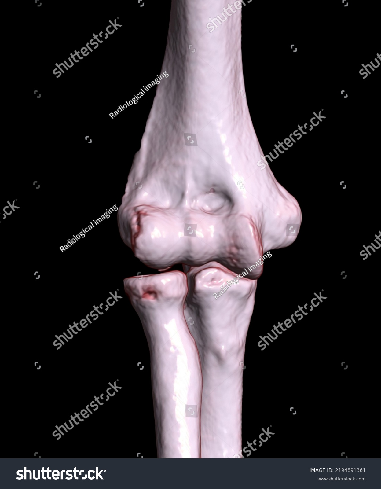 Ct Scan Elbow Joint 3d Rendering Stock Illustration 2194891361 Shutterstock