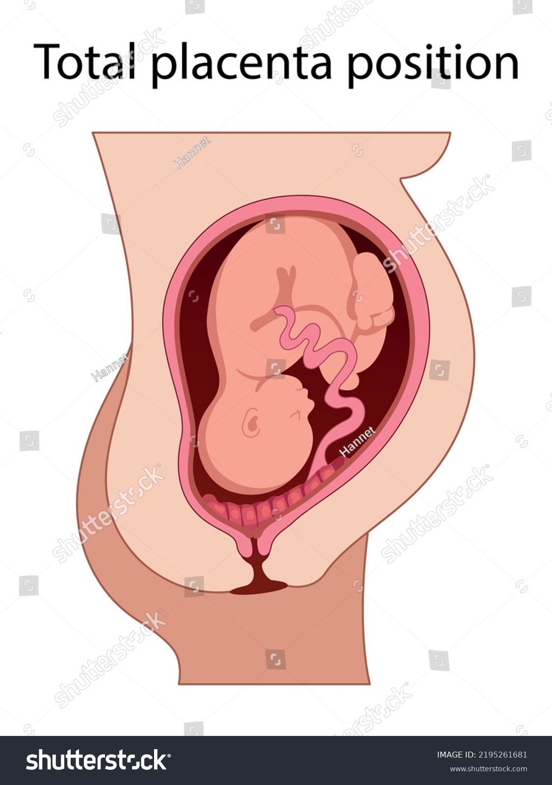 Placental Previa Fetus Uterus During Pregnancy Stock Vector Royalty Free 2195261681 Shutterstock