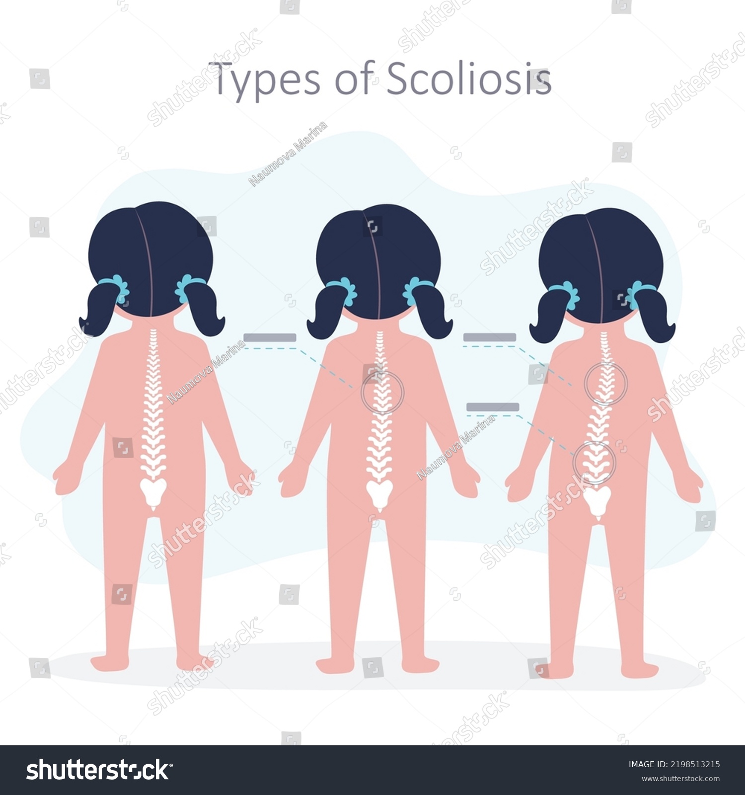 Educational Poster Different Types Scoliosis Child Stock Vector ... Educational Poster Different Types Scoliosis Child Stock Vector ...