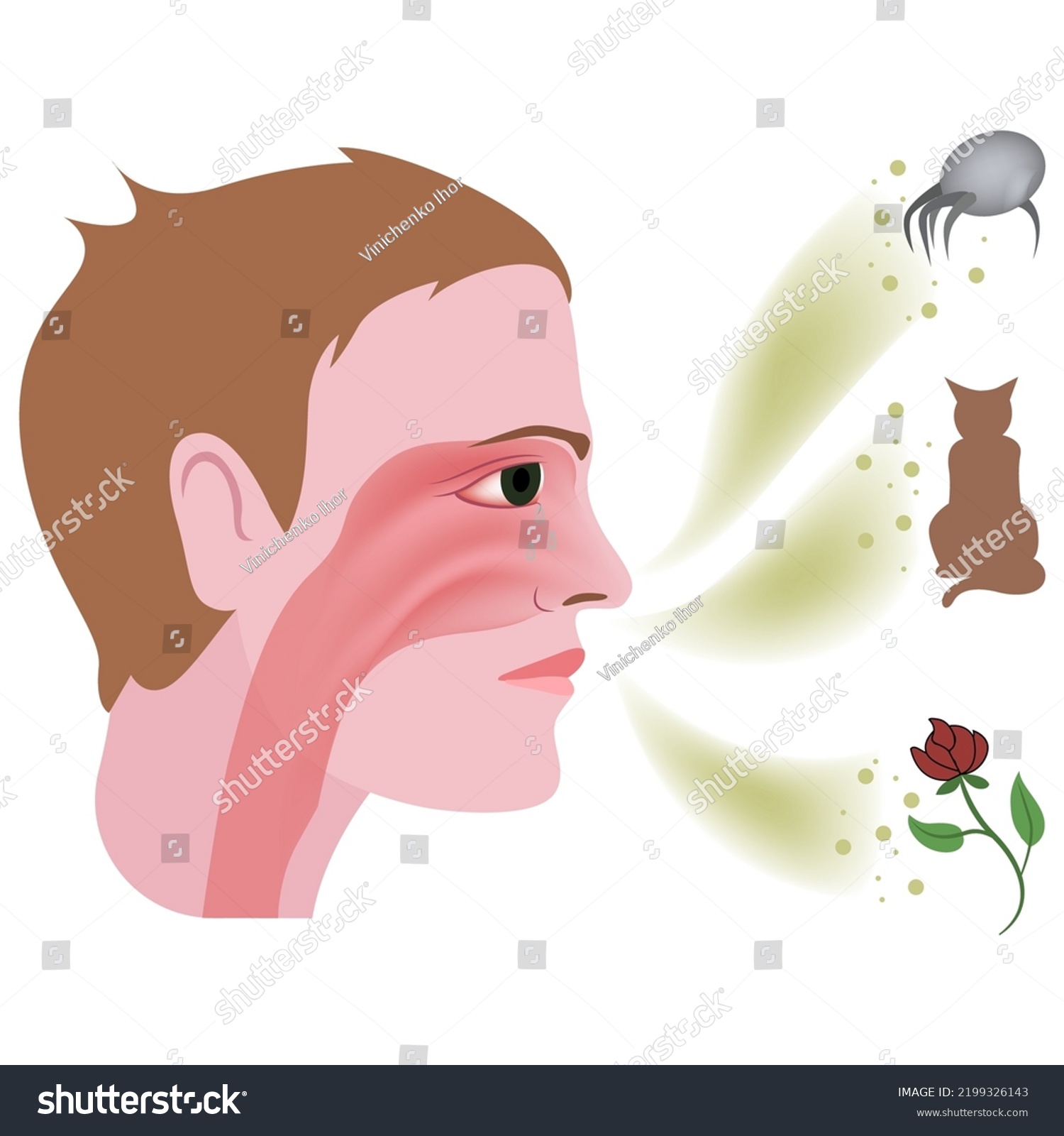 Allergic Rhinitis Disease Swelling Inflammation Nasal Stock Vector Royalty Free 2199326143
