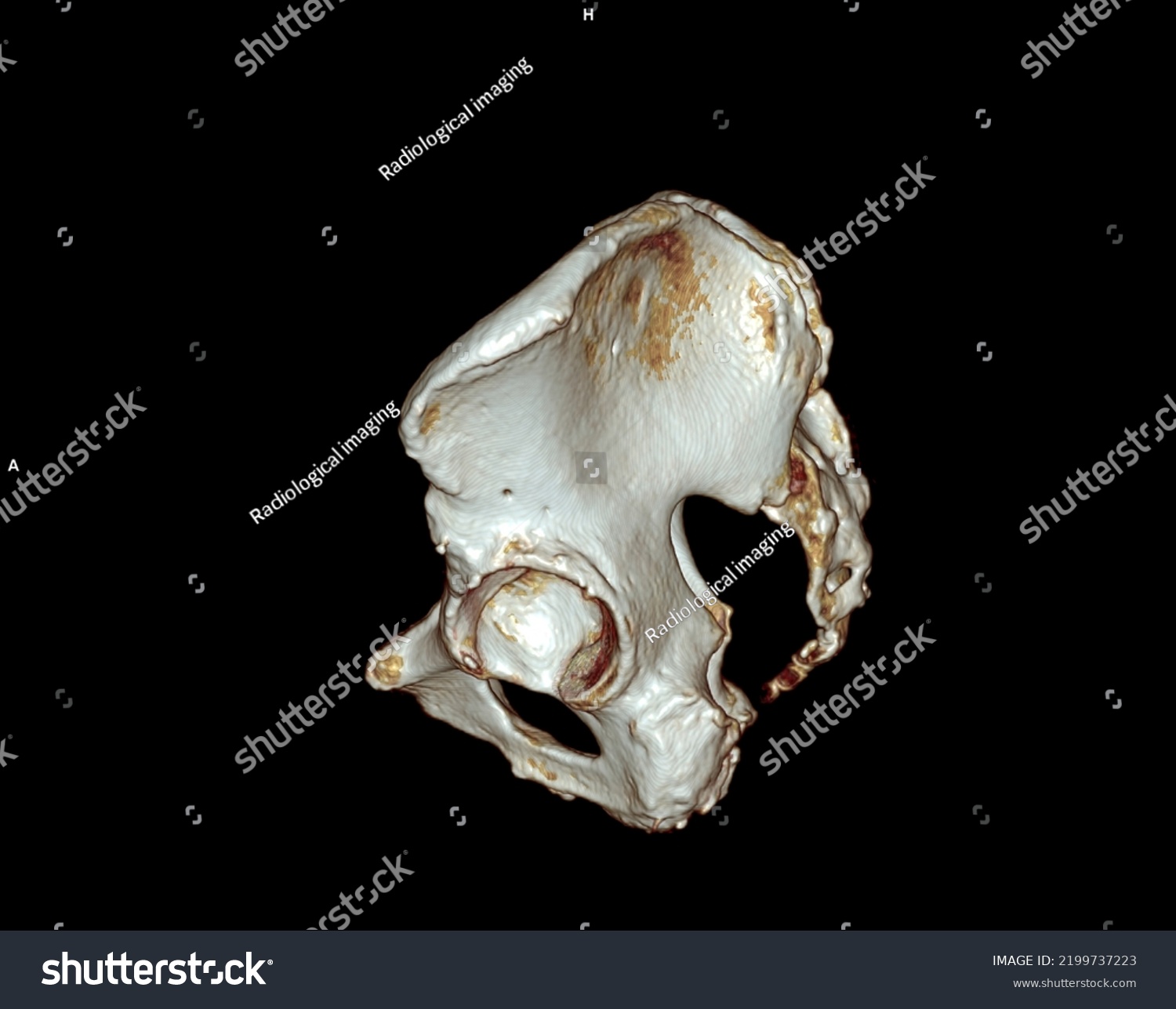 Ct Scan Pelvic Bone Hip Joint Stock Illustration 2199737223 | Shutterstock Ct Scan Pelvic Bone Hip Joint Stock Illustration 2199737223 | Shutterstock
