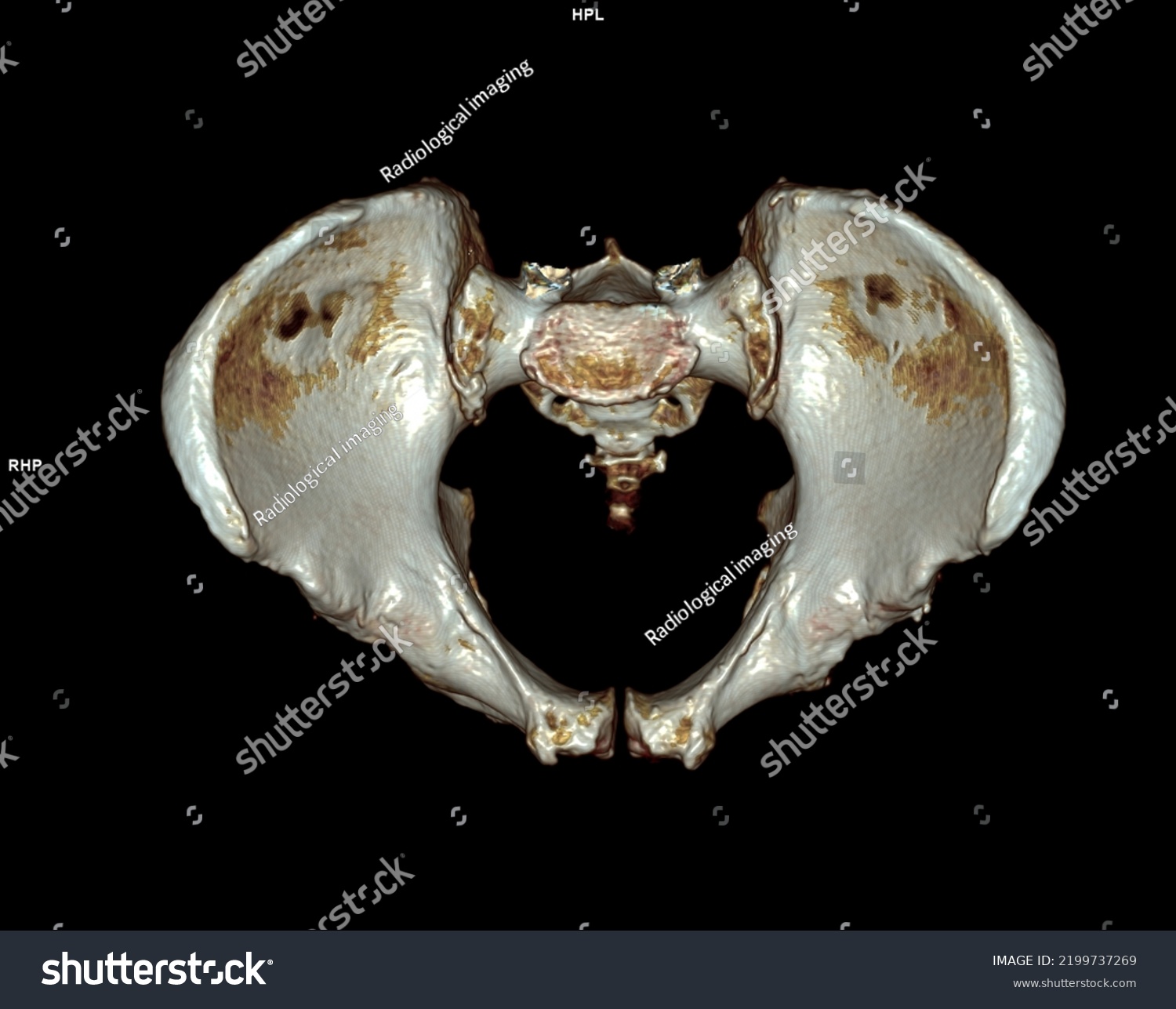 Ct Scan Pelvic Bone Hip Joint Stock Illustration 2199737269 | Shutterstock Ct Scan Pelvic Bone Hip Joint Stock Illustration 2199737269 | Shutterstock