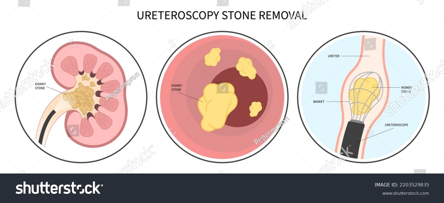 Urologist Biopsy Treatment Kidney Stone Removal Stock Vector (Royalty ... Urologist Biopsy Treatment Kidney Stone Removal Stock Vector (Royalty ...