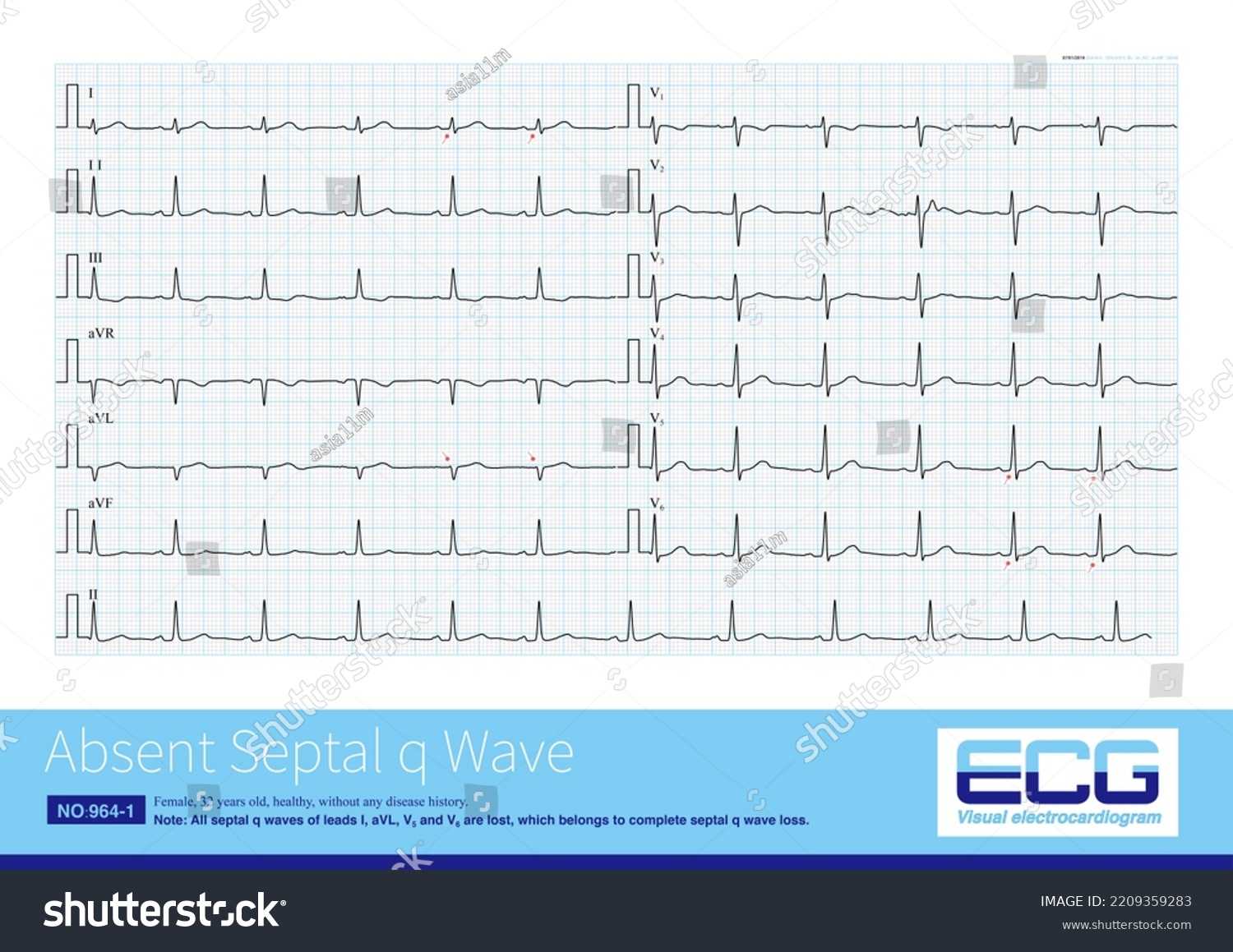 Absent Septal Q Wave Ecg May Stock Illustration 2209359283 Shutterstock