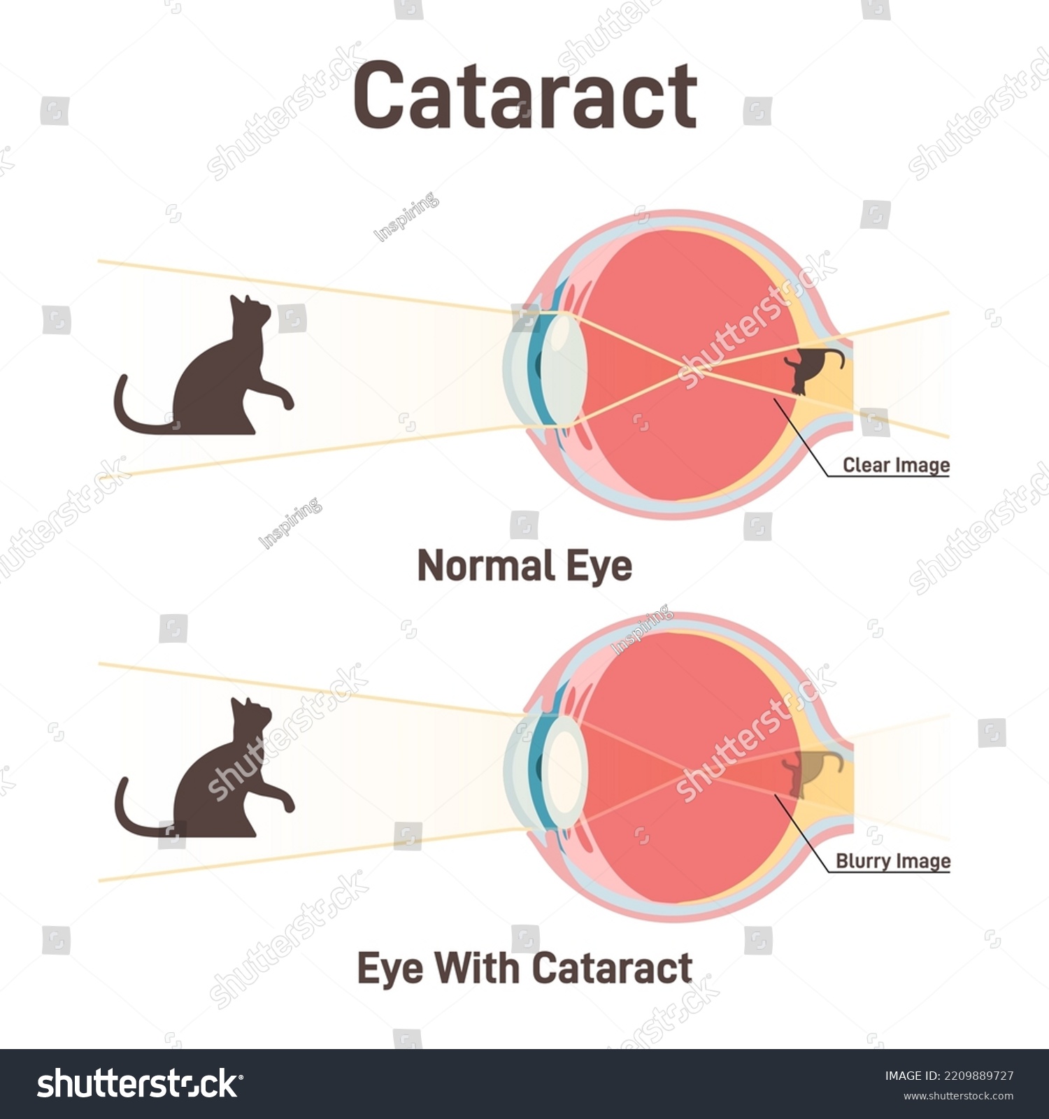 Cataract Clouding Lens Decrease Vision Anatomical Stock Vector (Royalty ...