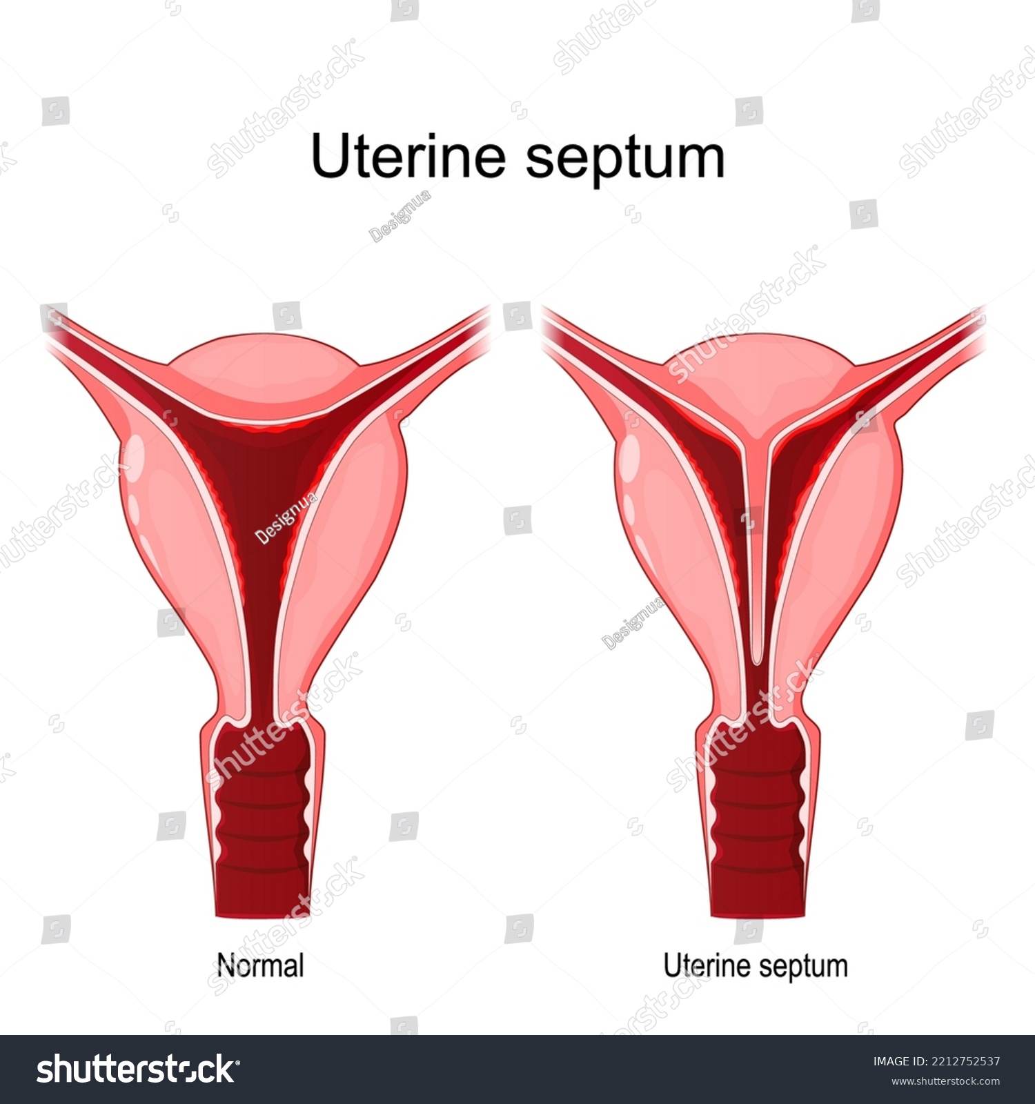 Uterine Septum Comparison Difference Between Normal Stock Vector Royalty Free 2212752537
