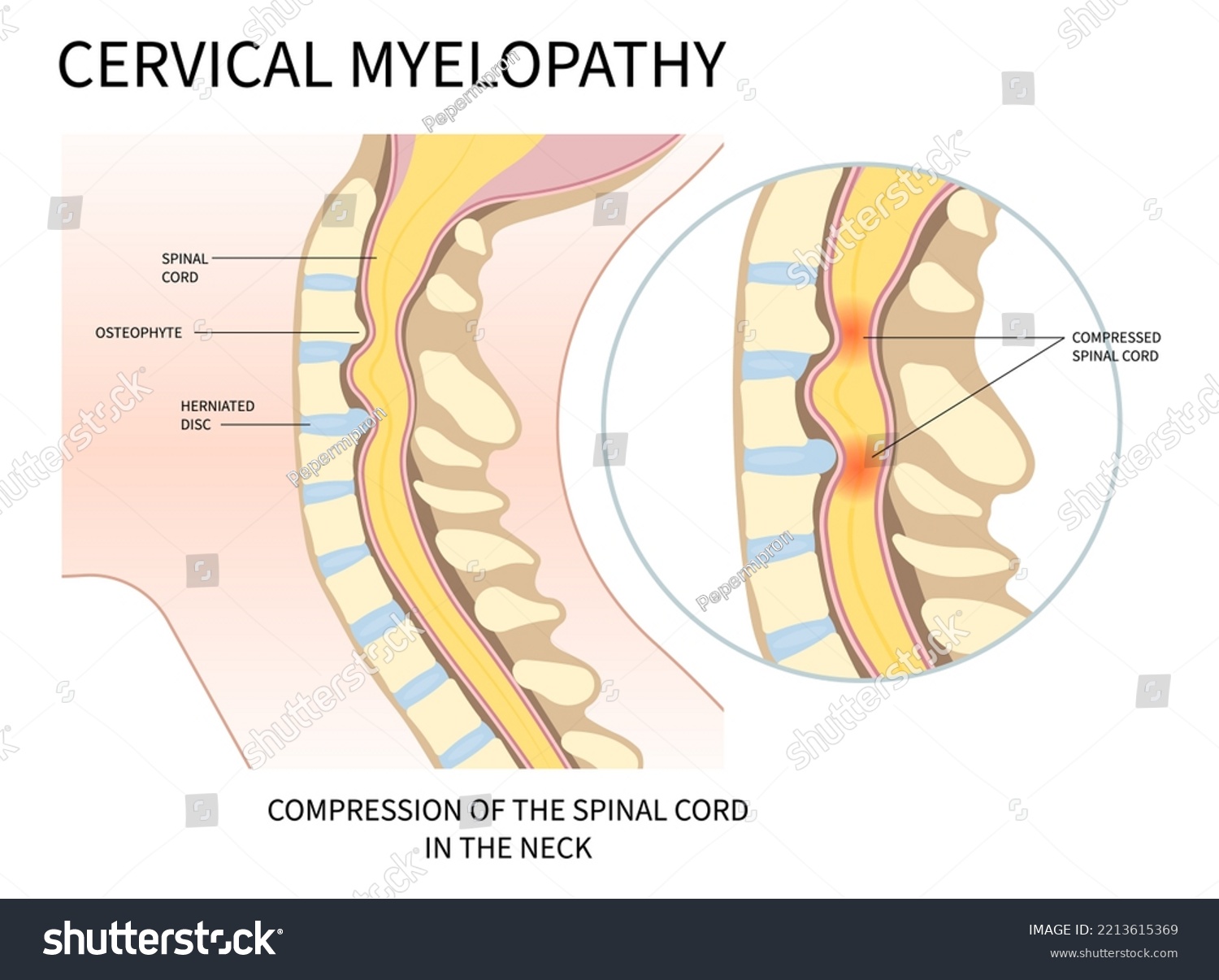 Cervical Nerve Root Compression That Cause Stock Vector Royalty Free 2213615369 Shutterstock
