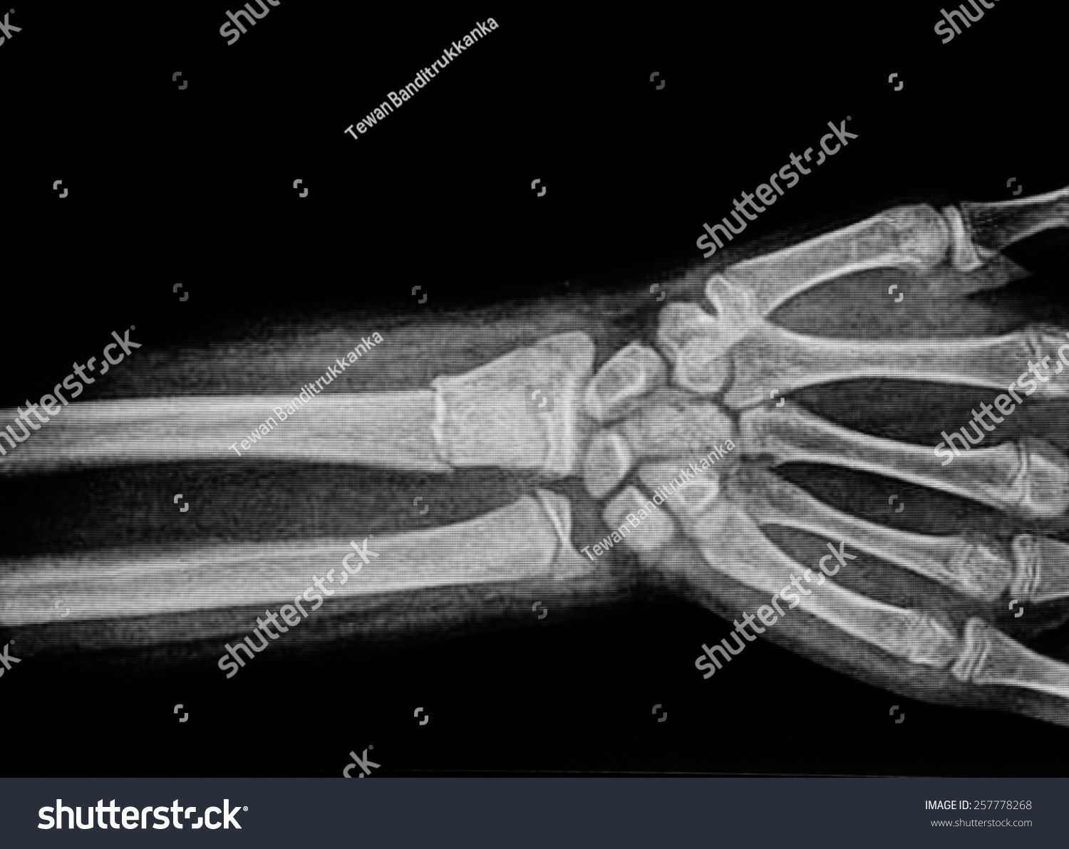 Film Xray Wrist Show Fracture Distal Stock Photo 257778268 | Shutterstock Film Xray Wrist Show Fracture Distal Stock Photo 257778268 | Shutterstock