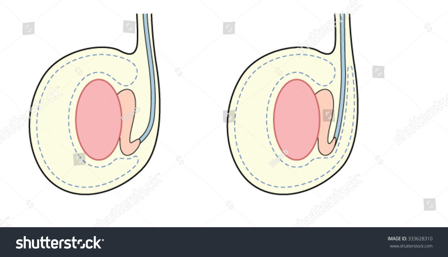 Testicle High Tunica Vaginalis Predisposing Factor Stock Vector