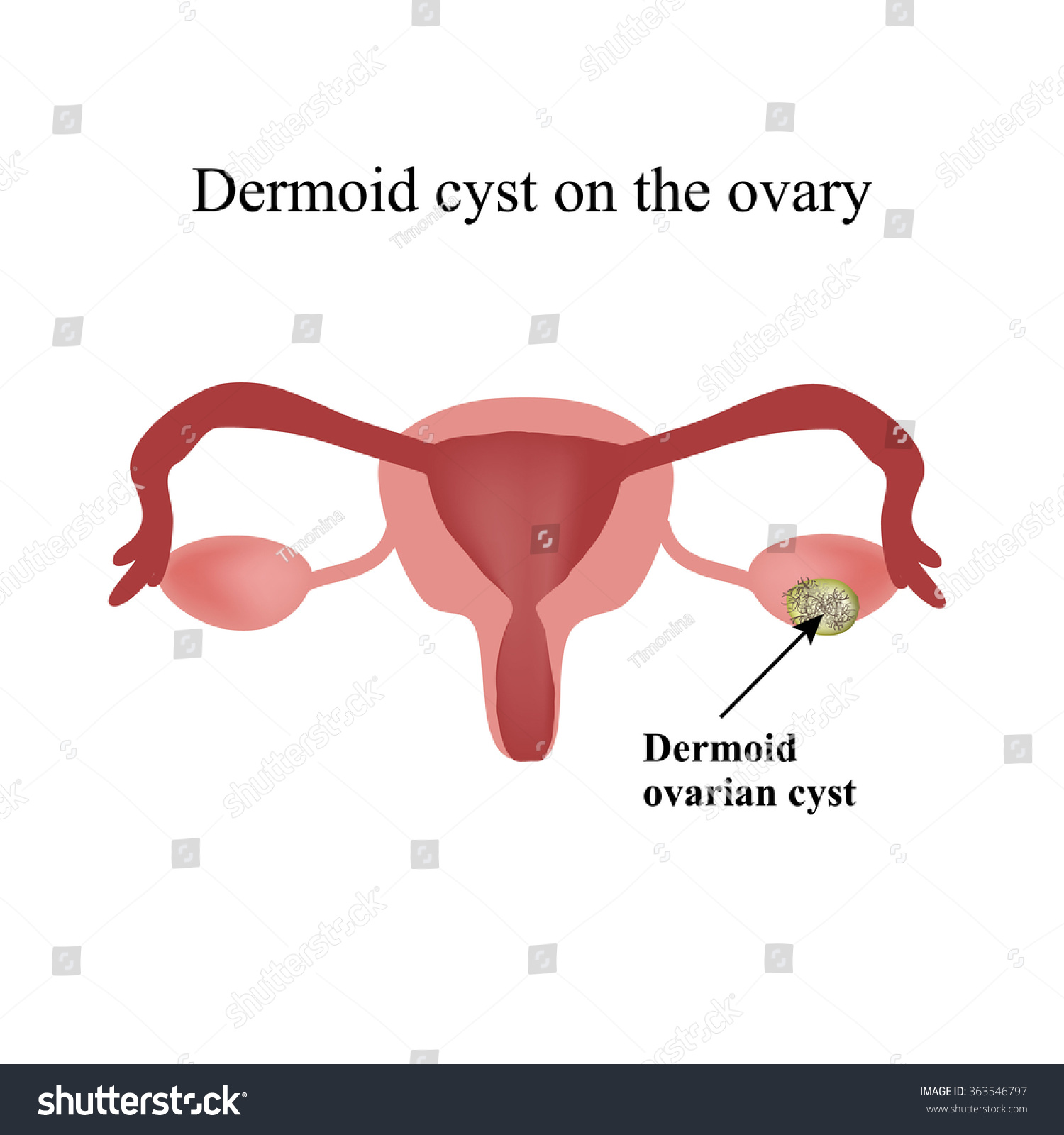 Dermoid Cyst On Ovary Ovary Infographics Stock Vector Royalty Free