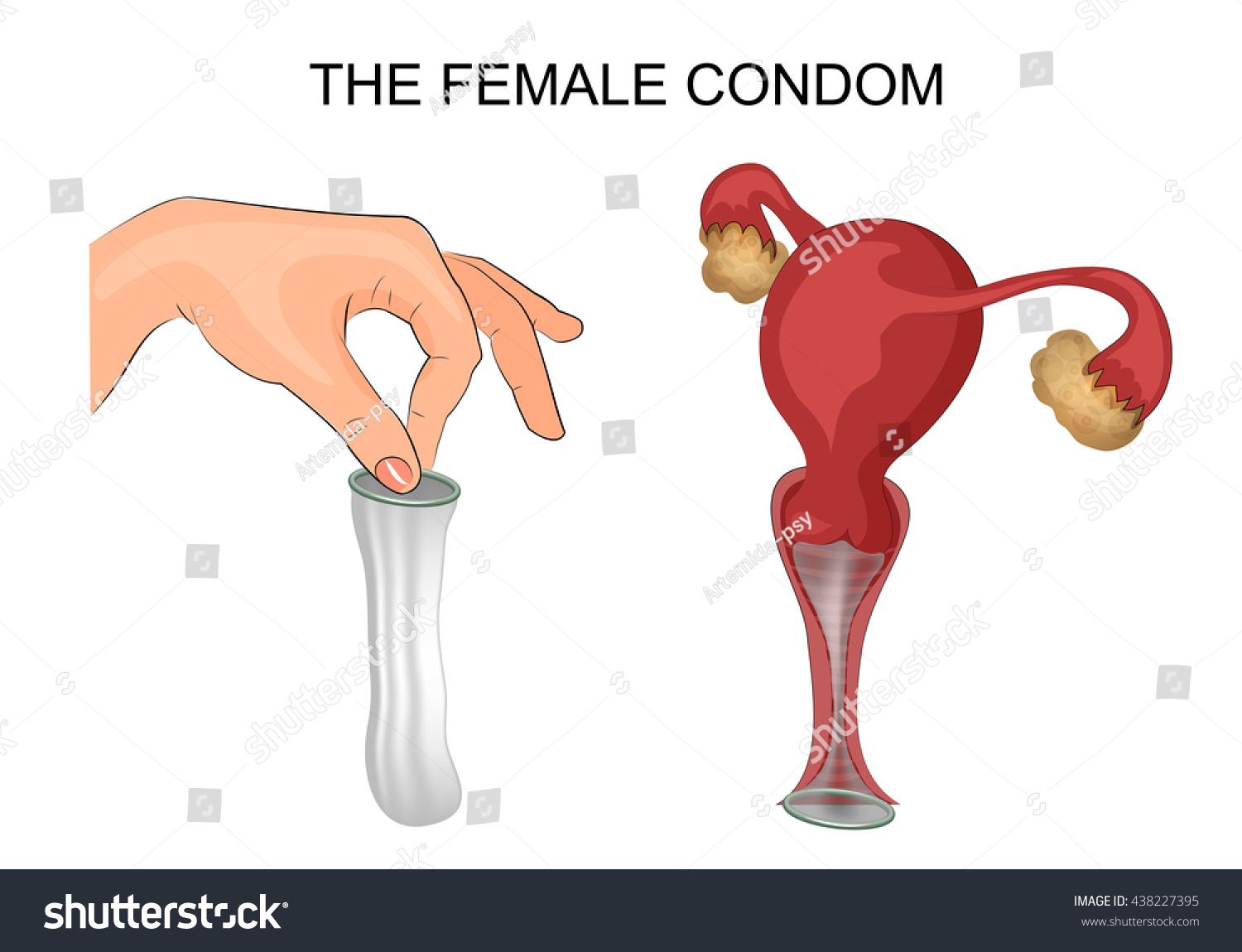 Illustration Female Condom Method Application Uterus Stock Vector Royalty Free 438227395