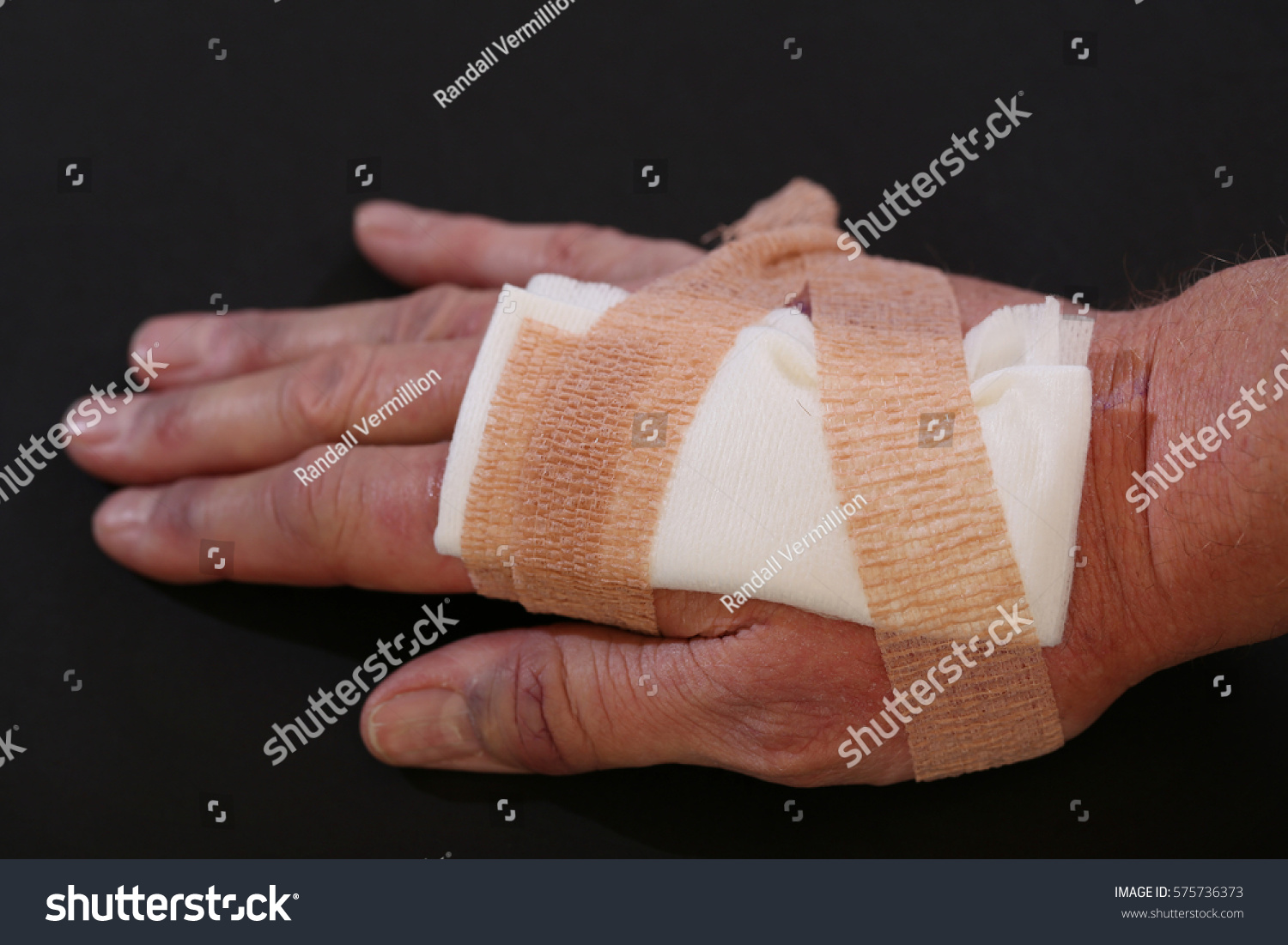 Suture Wound On Hand Dermatology Procedure Stock Photo 575736373 ... Suture Wound On Hand Dermatology Procedure Stock Photo 575736373 ...