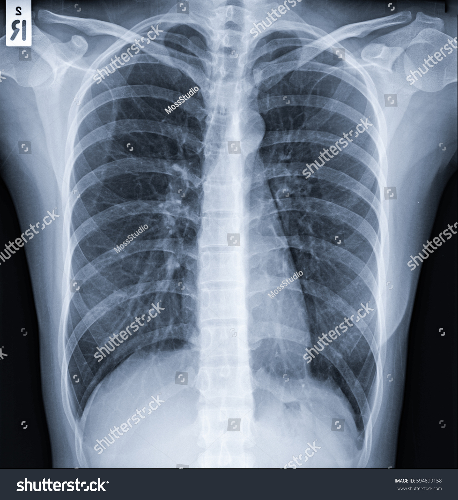 Chest X Ray Pa View Anatomy At Nancy Ramirez Blog