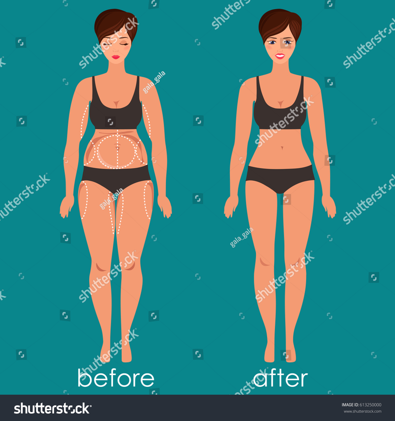 Woman Body Before After Plastic Surgery Stock Vector Royalty Free
