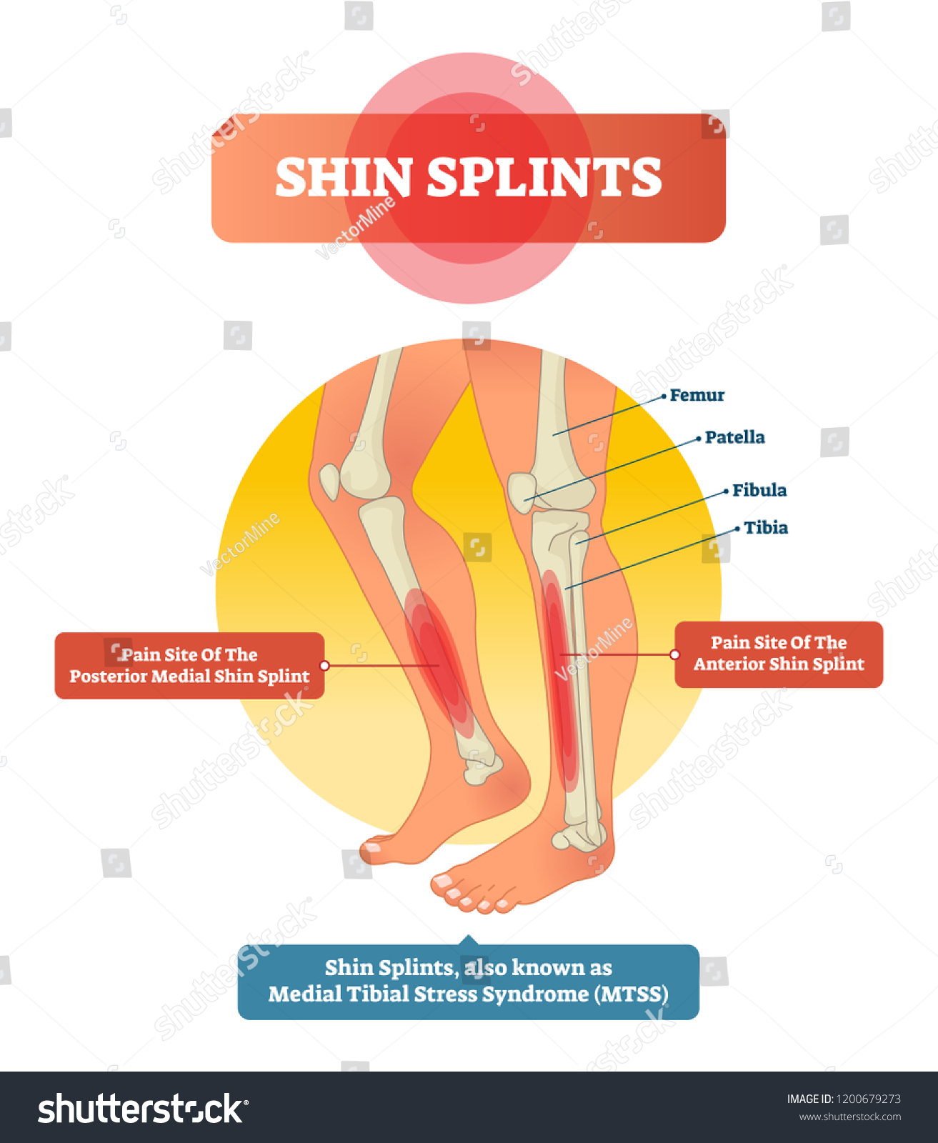 Shin splints vector illustration. Leg muscle - Royalty Free Stock ...
