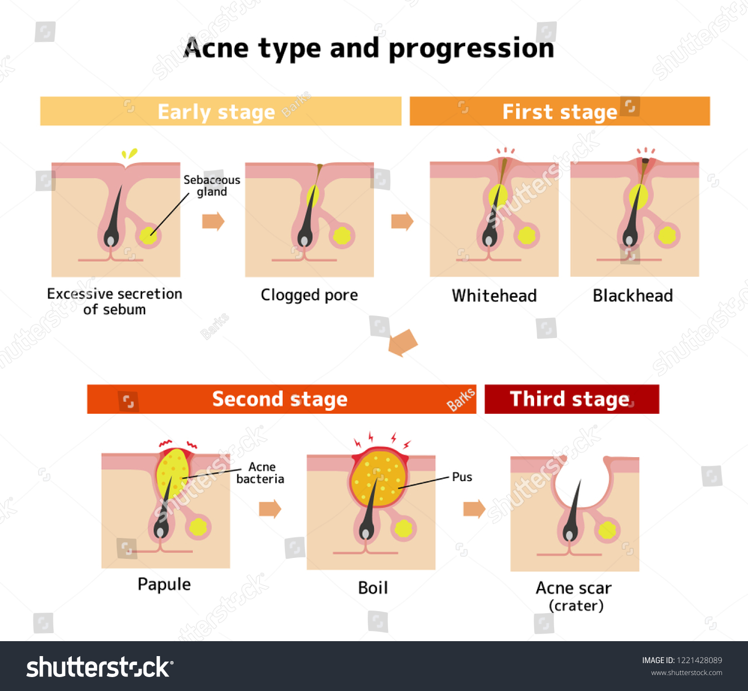 Acne types and progression illustration - Royalty Free Stock Vector ...