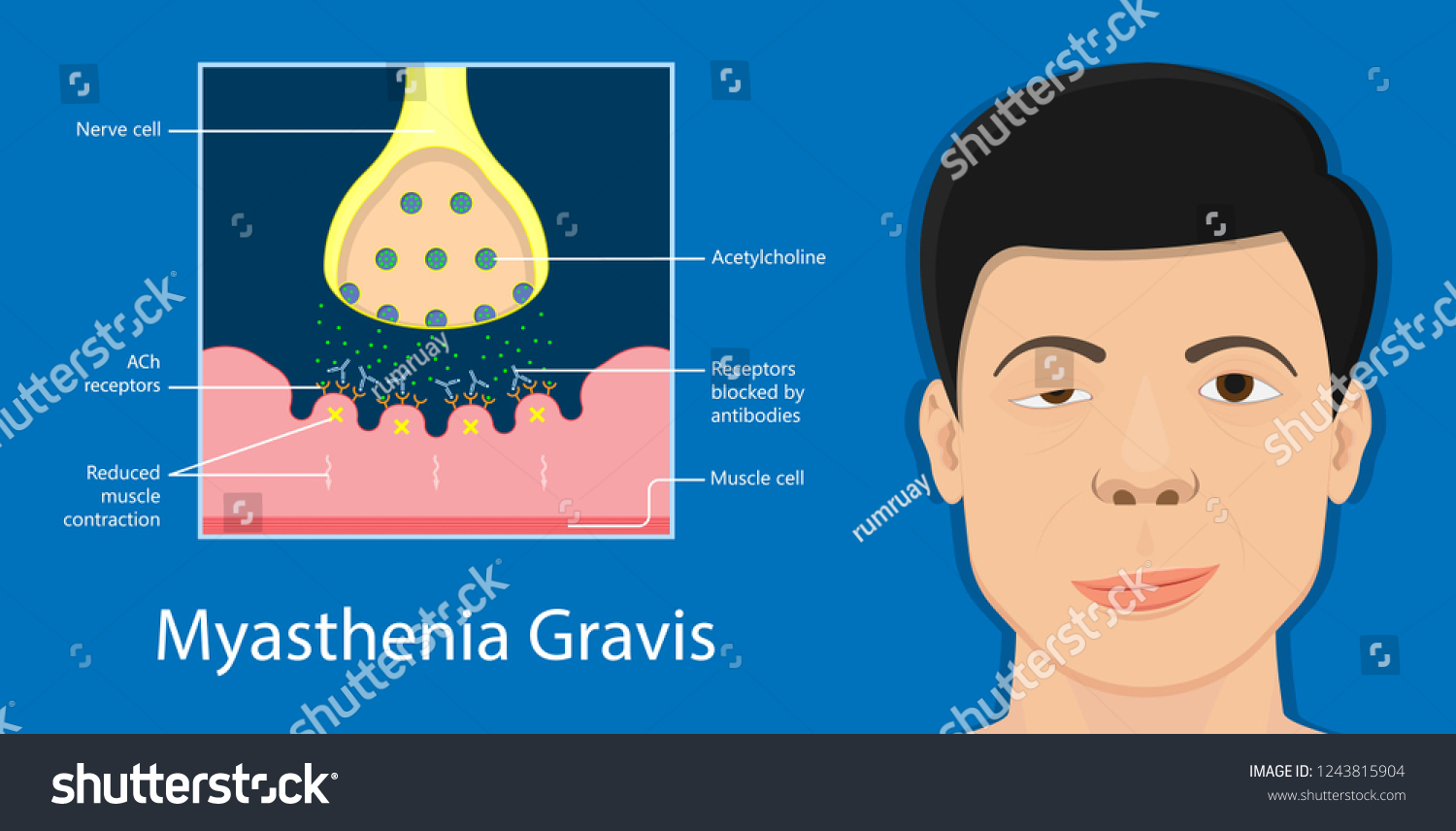 Myasthenia gravis (MG) disease treatment - Royalty Free Stock Vector ... Myasthenia gravis (MG) disease treatment - Royalty Free Stock Vector ...