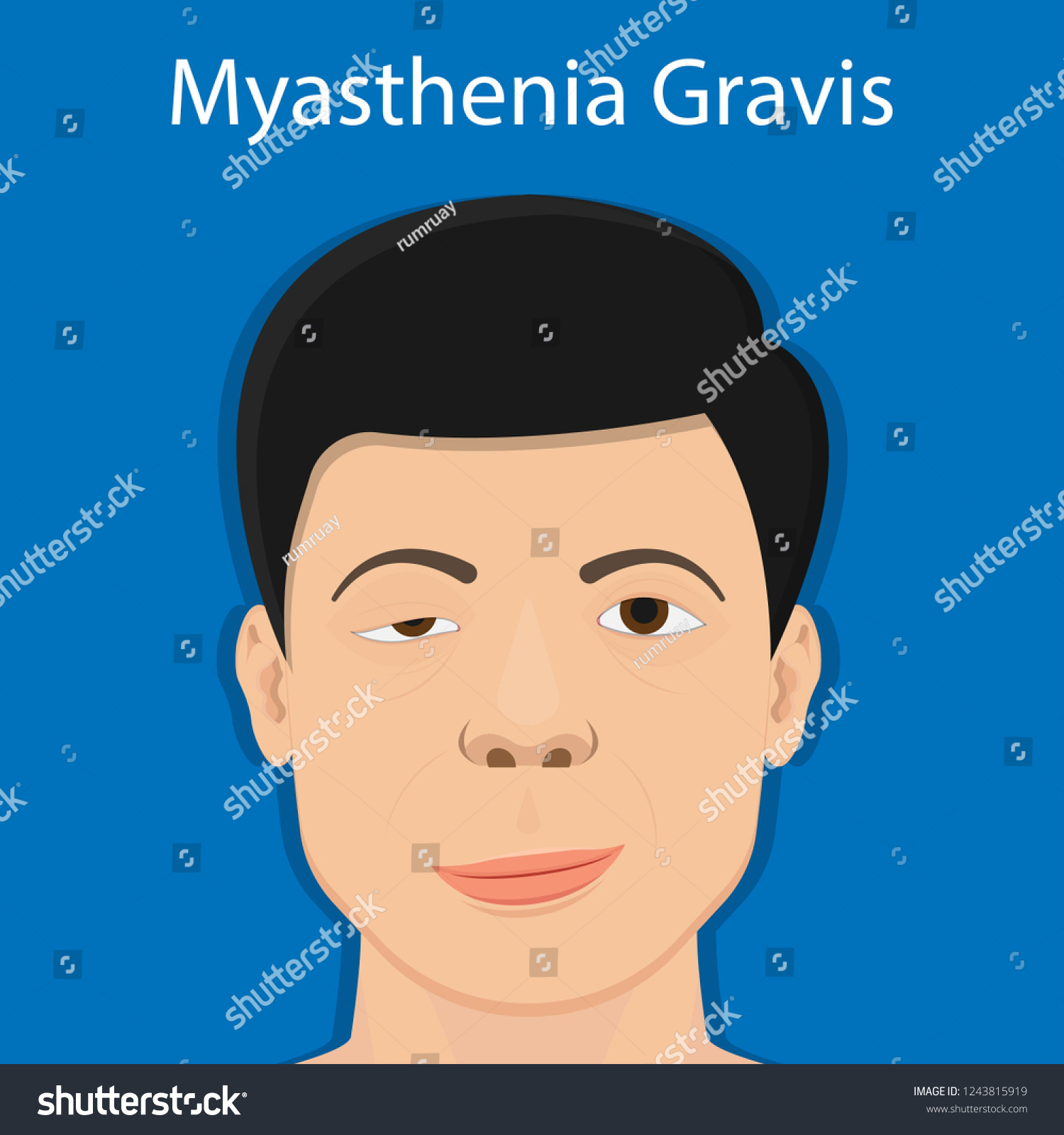 Myasthenia gravis (MG) disease treatment - Royalty Free Stock Vector ... Myasthenia gravis (MG) disease treatment - Royalty Free Stock Vector ...