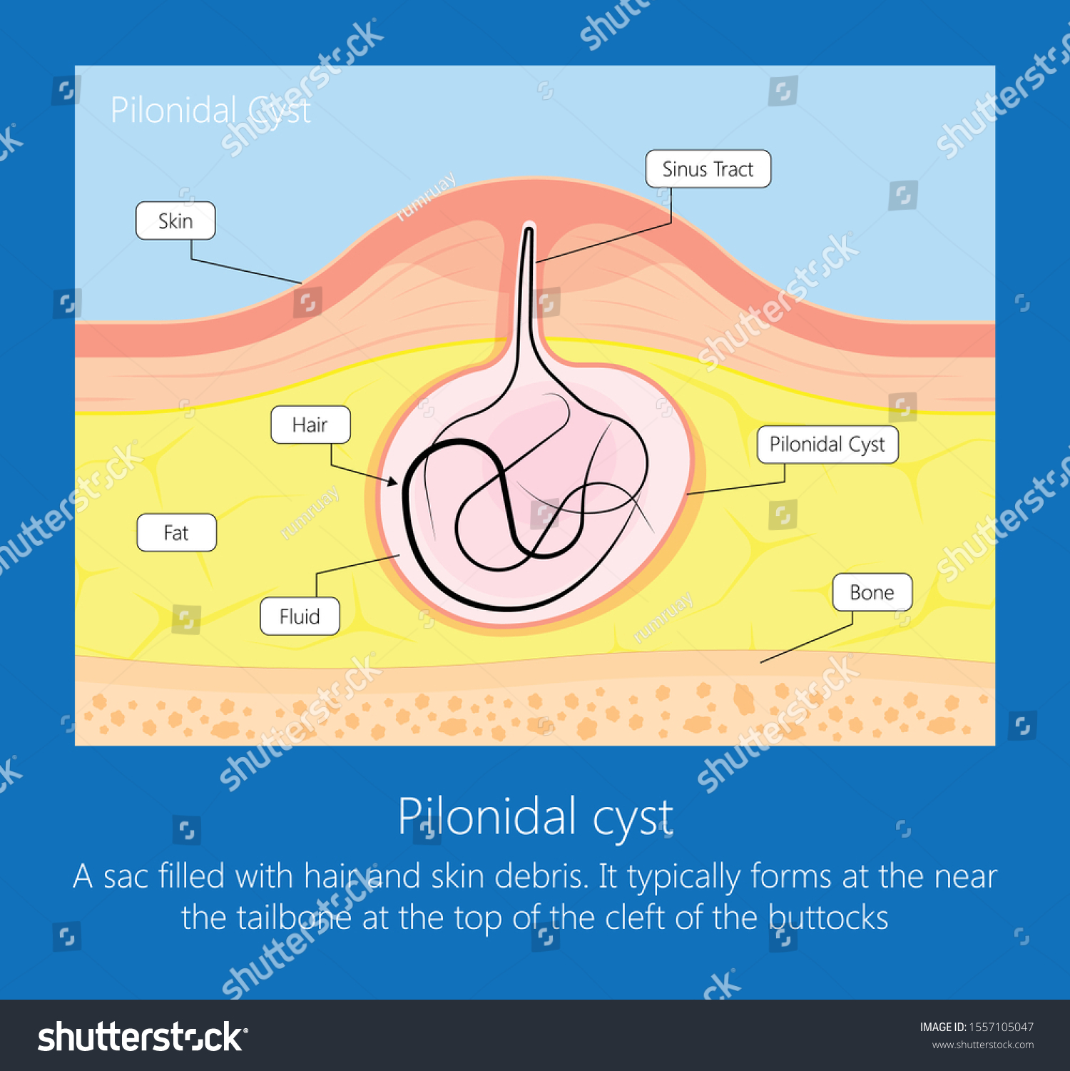 Pilonidal Cyst Nest Of Hair Causes From Royalty Free Stock Vector 1557105047