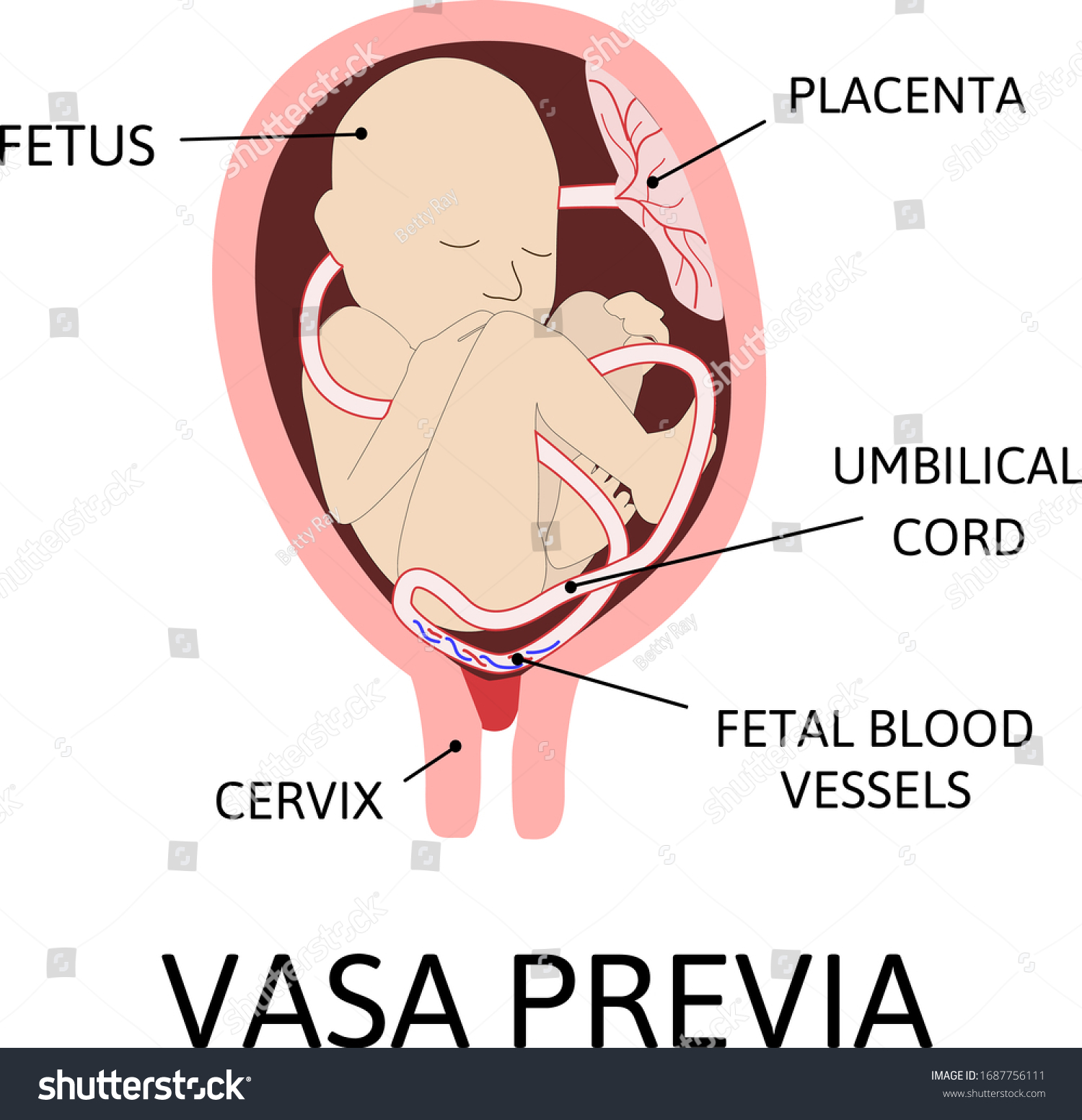 Vasa Praevia Is Fetal Blood Vessels Cross Or Run Royalty Free Stock