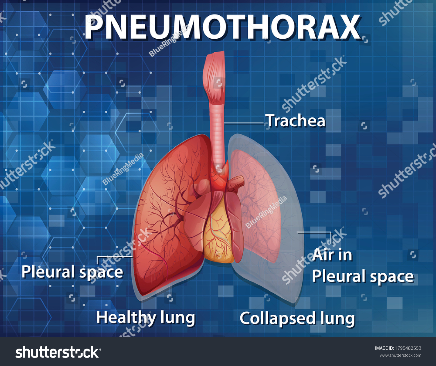 Informative illustration of Pneumothorax - Royalty Free Stock Vector ...