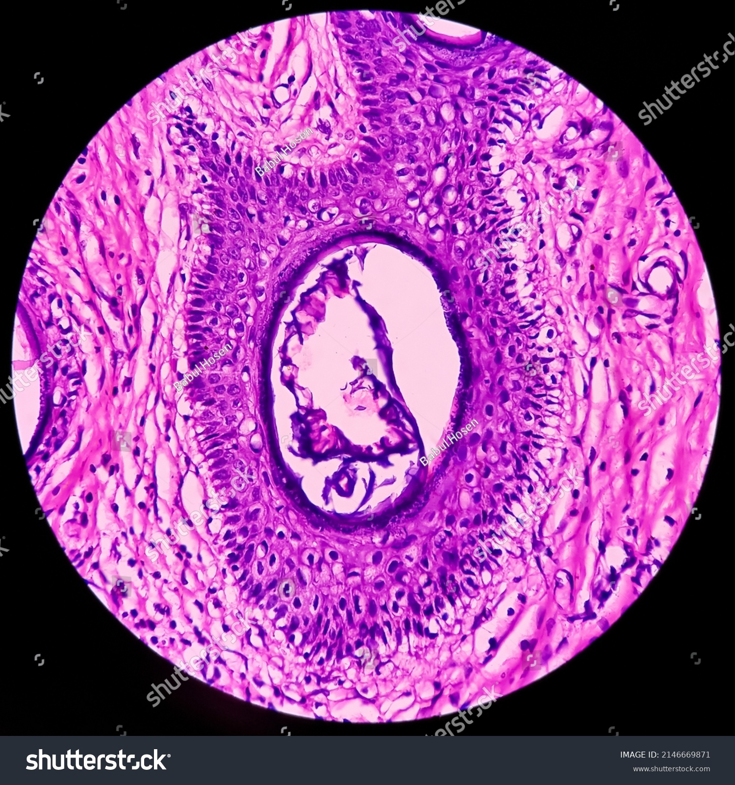 Ovarian Cyst Cystic Teratoma Microscopic Show Royalty Free Stock