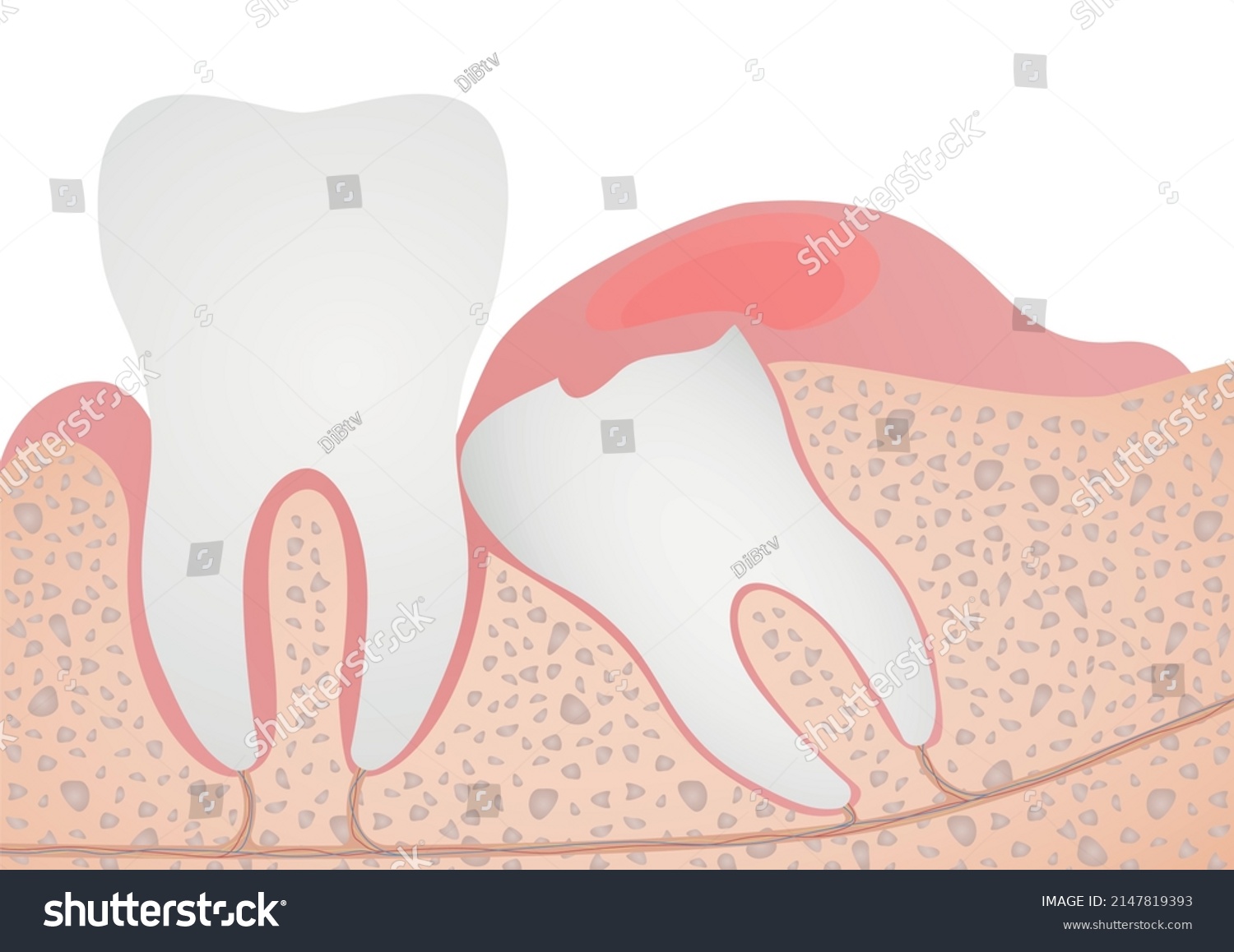 Wisdom Tooth Eruption Middle Age – IMCUI