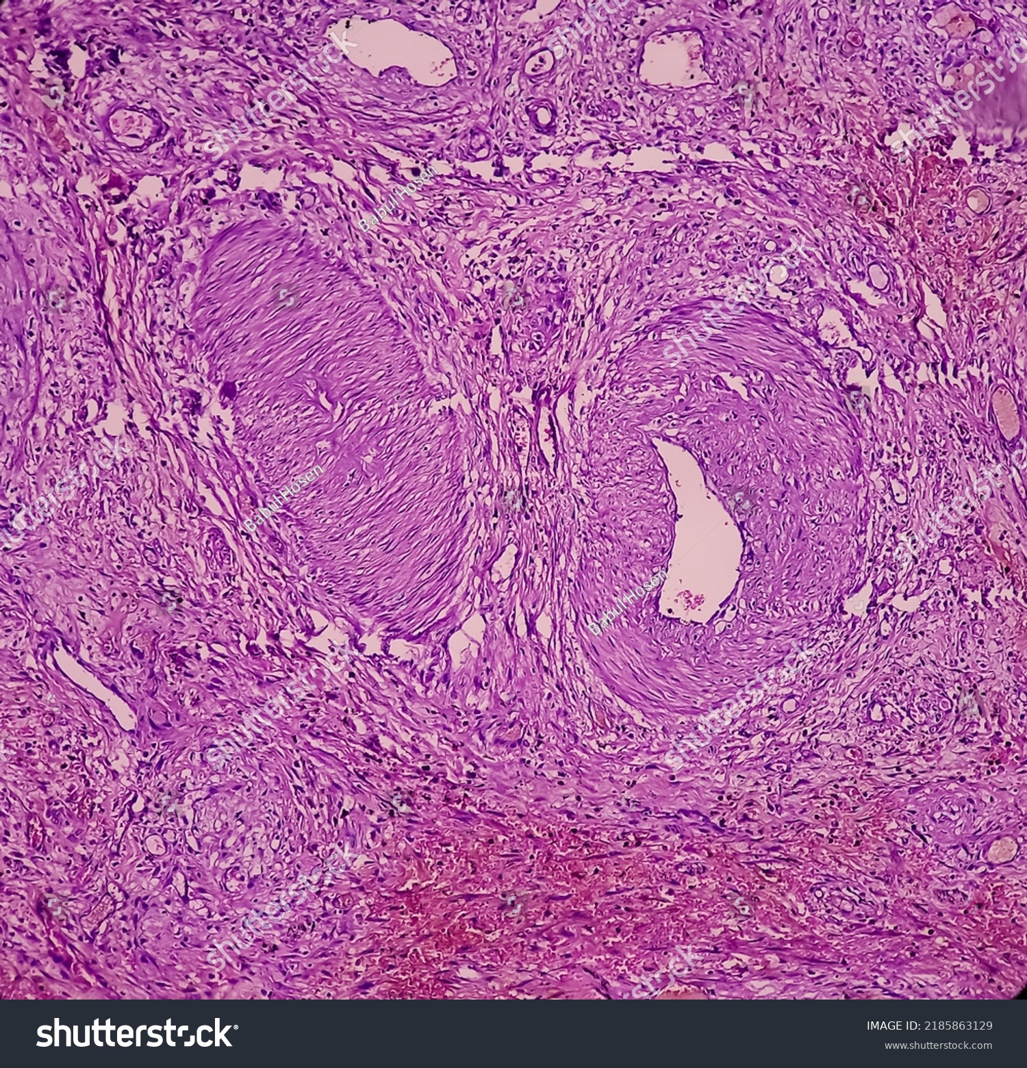 Dermoid Cyst Mature Cystic Teratoma Show Skin Royalty Free Stock