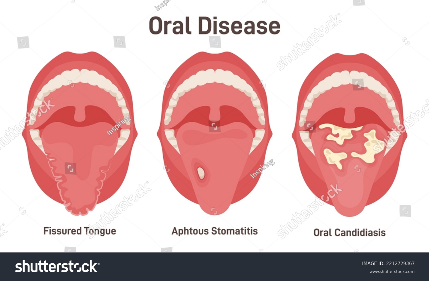 Tongue Problems Set Fissured Tongue Oral Royalty Free Stock Vector 2212729367