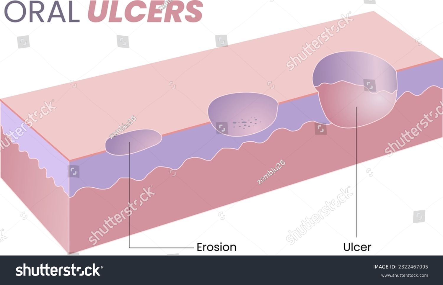 Illustration Of Oral Ulcer Diagram Royalty Free Stock Vector 2322467095