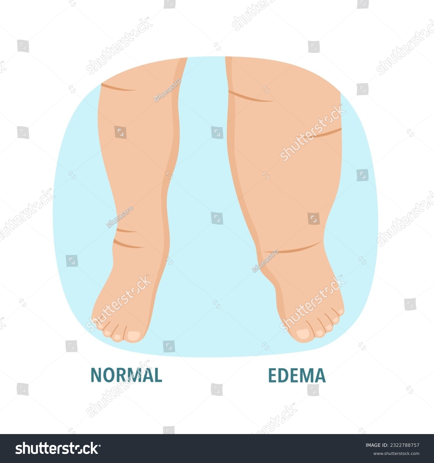 Edema foot swollen leg disease in flat design. - Royalty Free Stock ... Edema foot swollen leg disease in flat design. - Royalty Free Stock ...