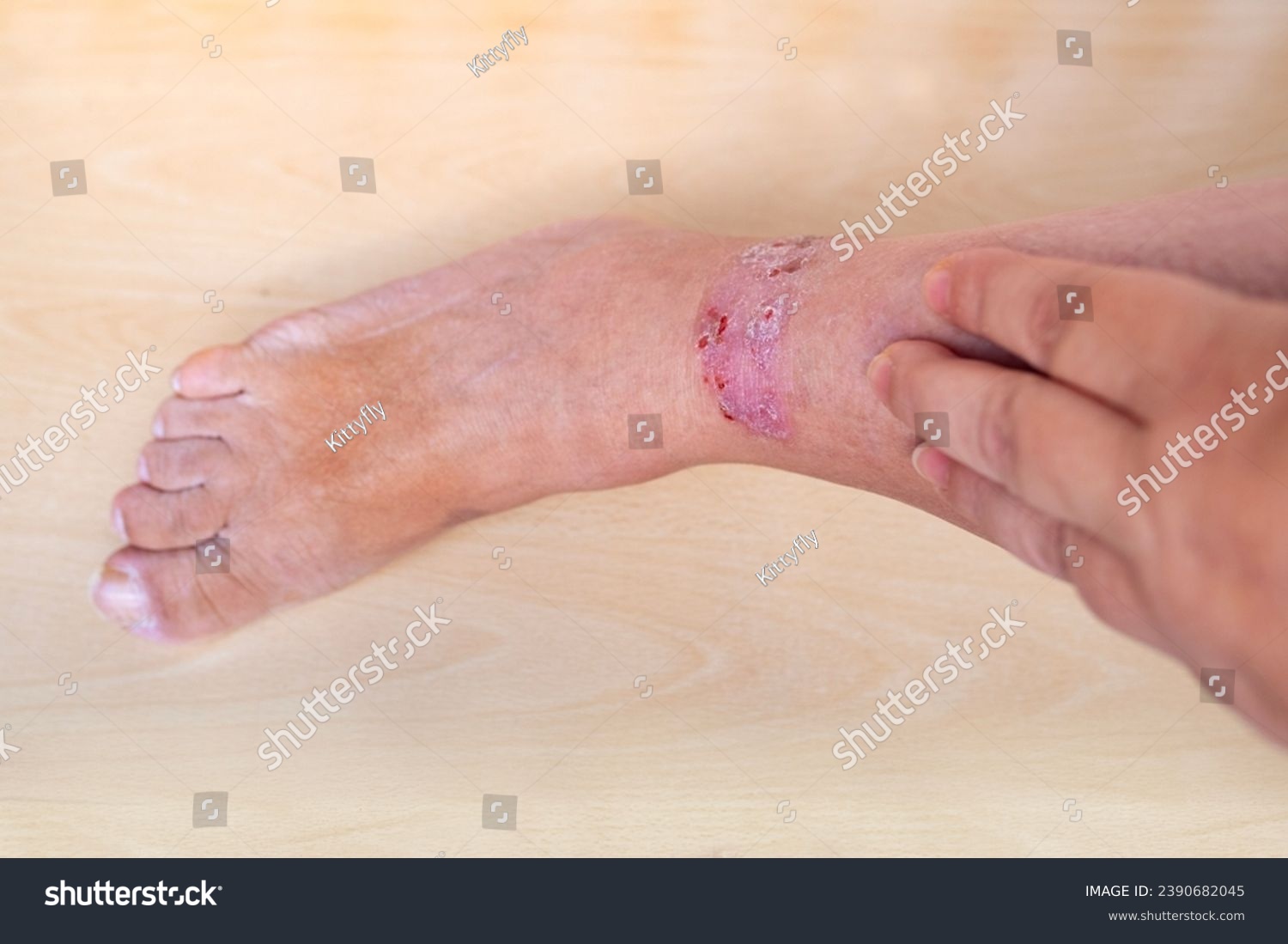 Rash Hives Itchy Skin On Leg Inflammation And Royalty Free Stock