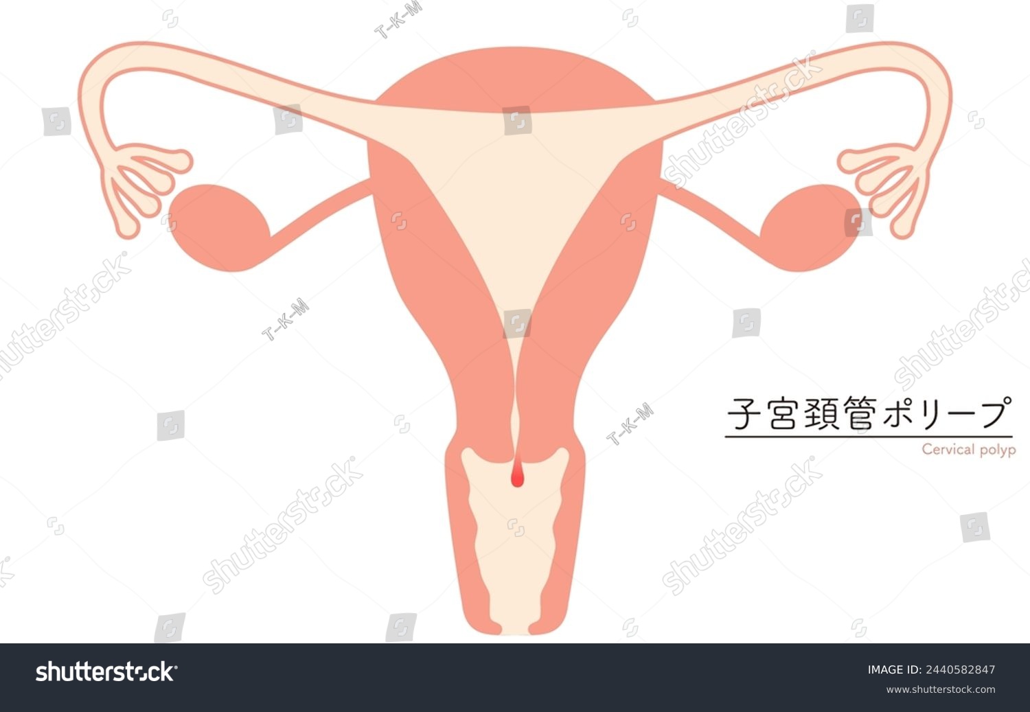 Diagrammatic Illustration Of Cervical Polyps Royalty Free Stock