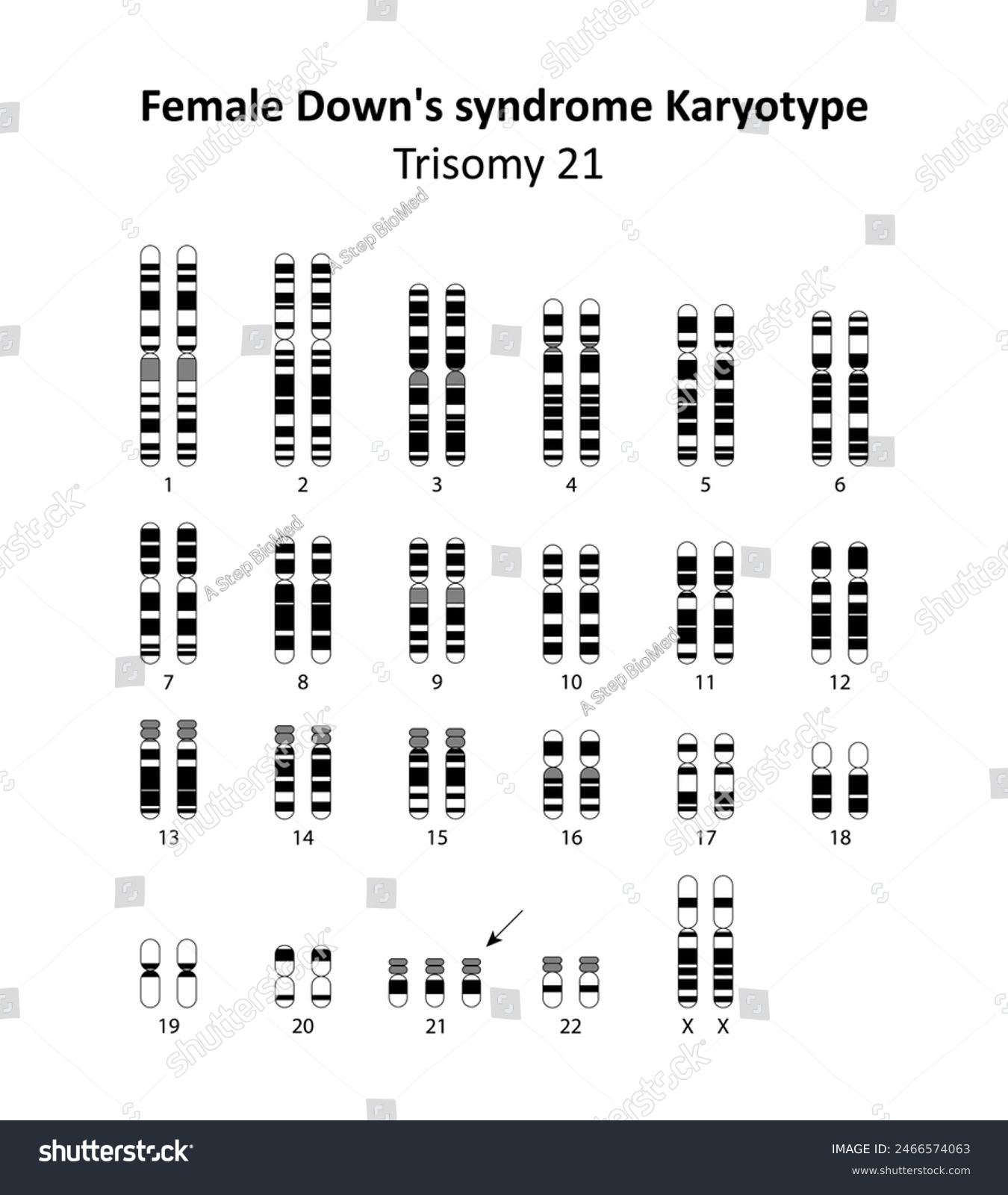 Female Down's syndrome (trisomy 21) human - Royalty Free Stock Vector 2466574063 - Avopix.com