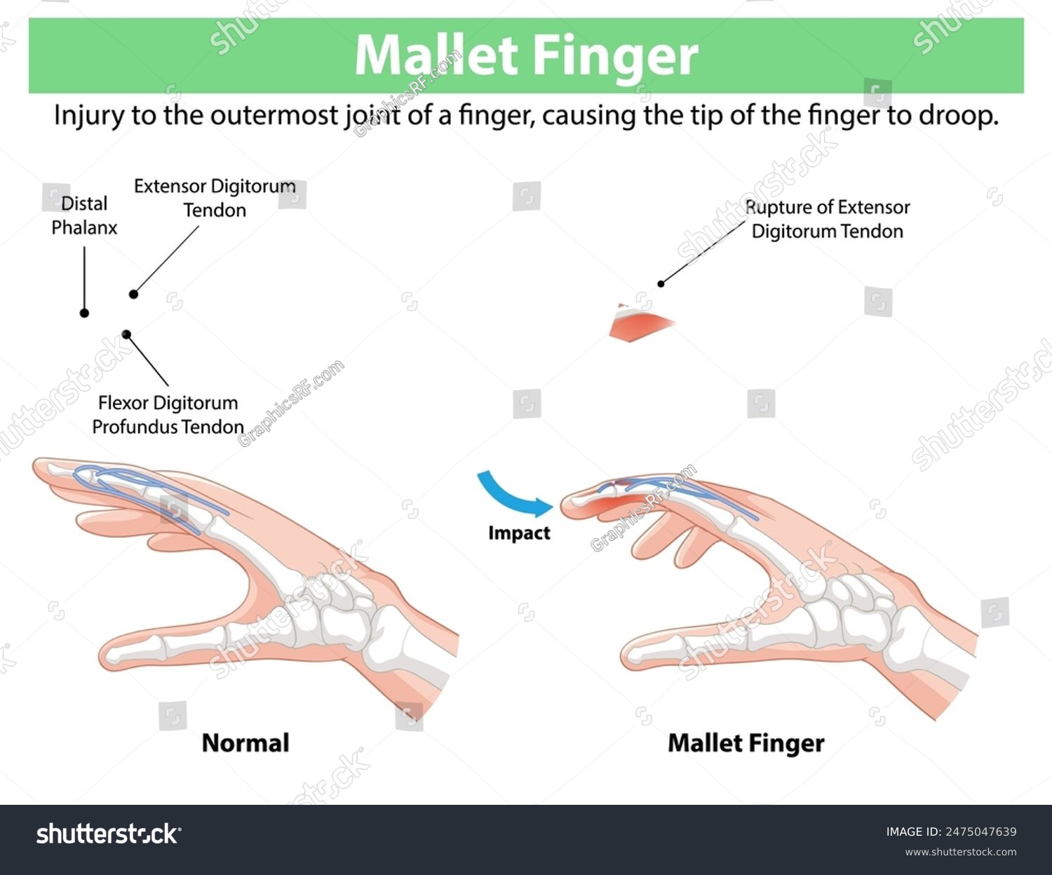 Diagram showing normal and mallet finger - Royalty Free Stock Vector ...
