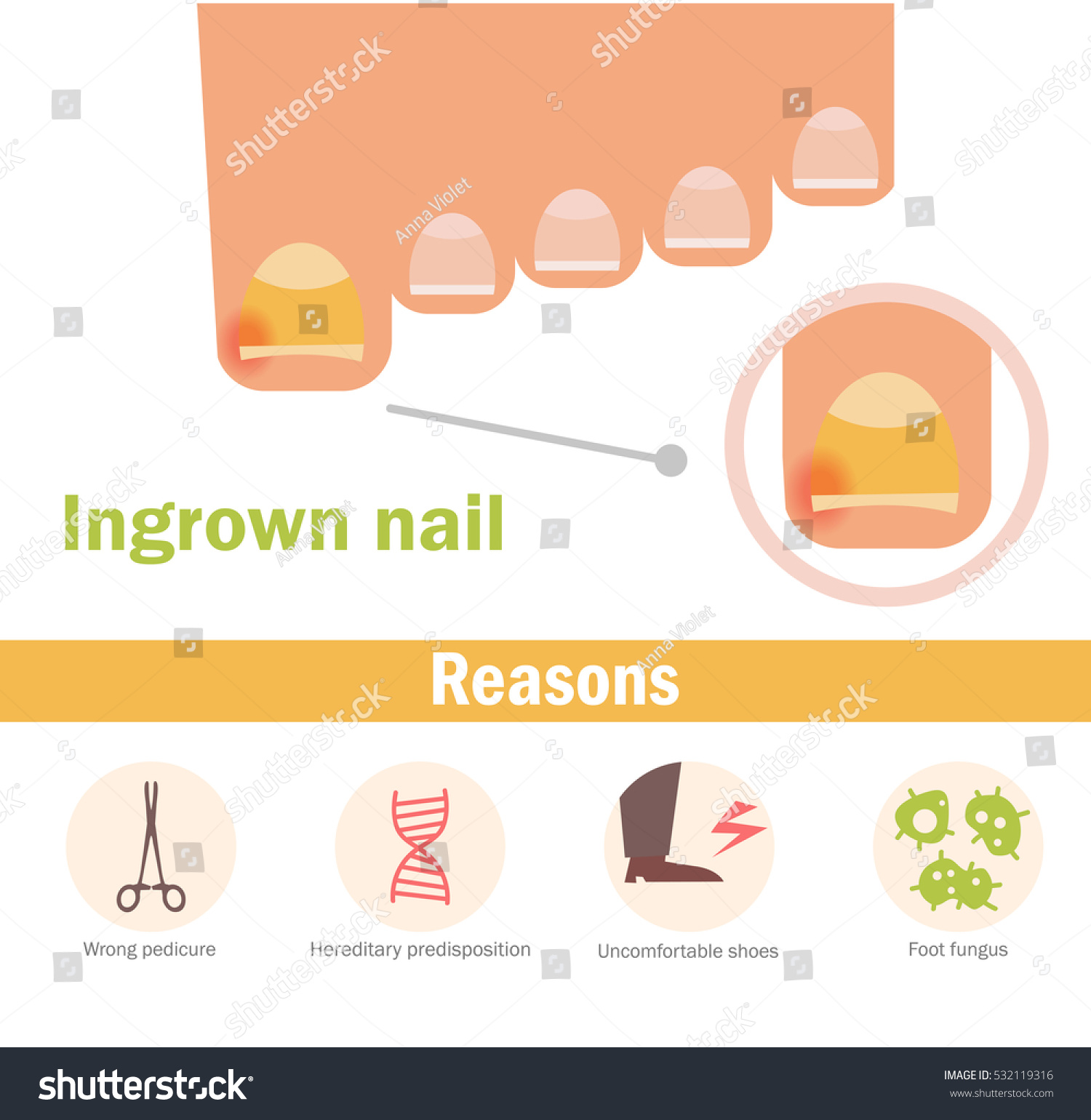 Ingrown nail. Vector. Cartoon. Isolated. Flat. - Royalty Free Stock ...