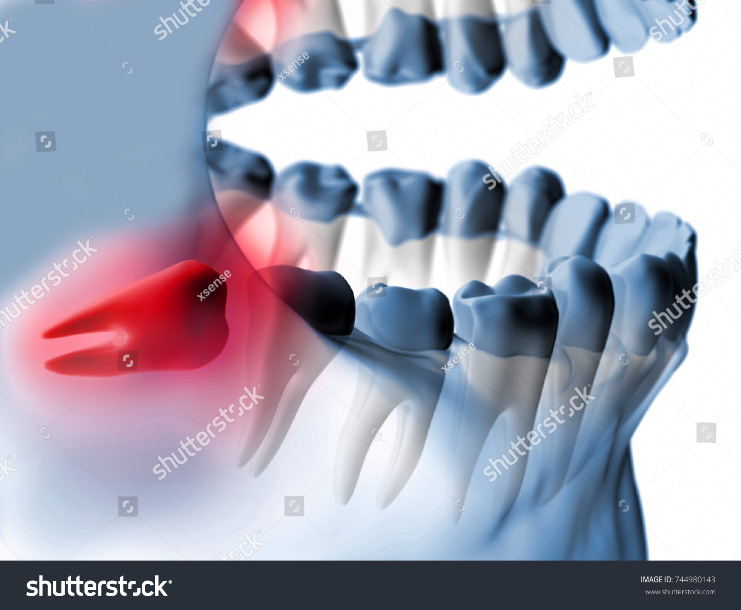 214 Embedded tooth 이미지, 스톡 사진 및 벡터 | Shutterstock