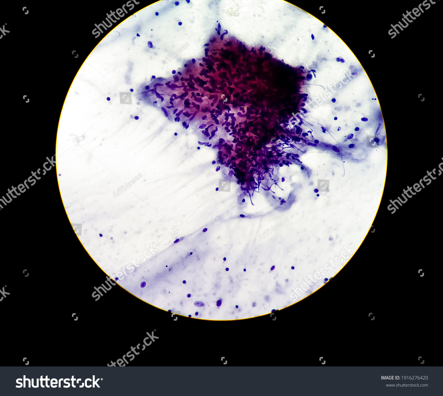 Tuberculosis micobacteriana en nódulos linfáticos supraclaviculares ... Tuberculosis micobacteriana en nódulos linfáticos supraclaviculares ...