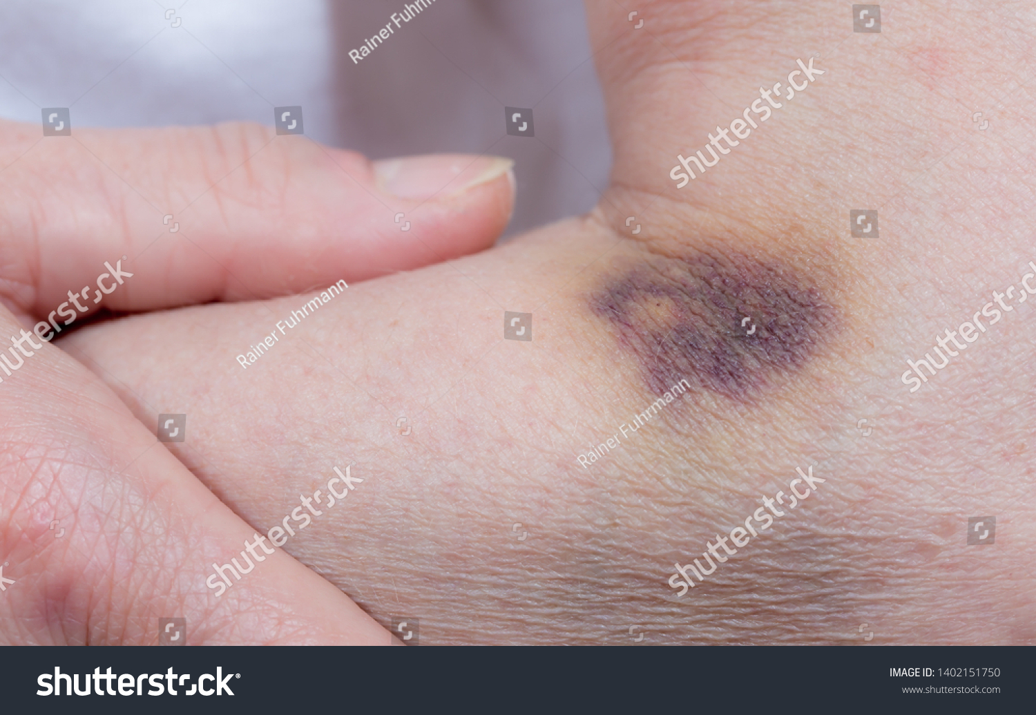 Strong Hematoma Due Wrong Injection Concept Foto De Stock 1402151750 Shutterstock