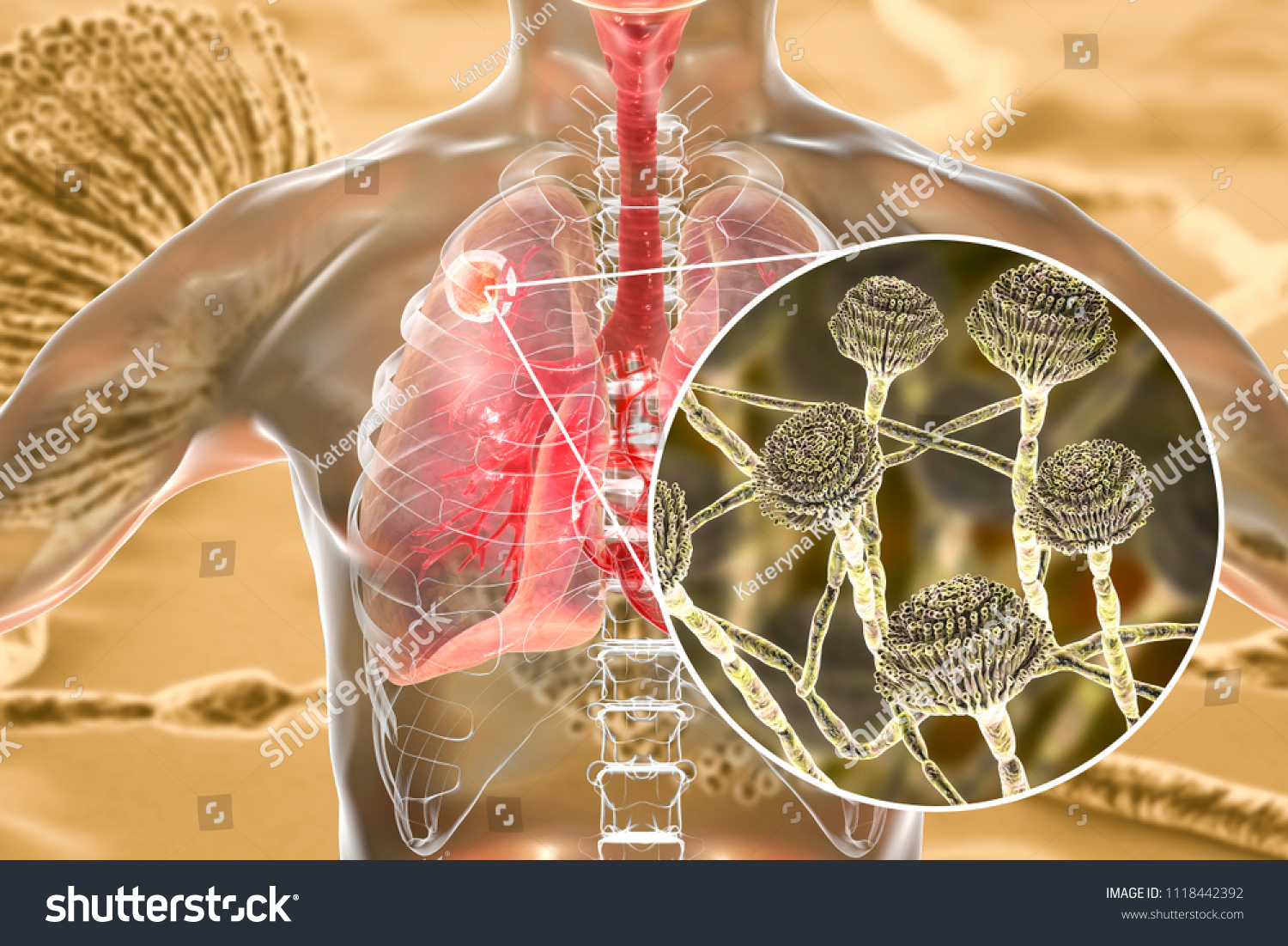 Aspergilloma Lung Closeup View Aspergillus Fungi Stock Illustration 1118442392 Shutterstock