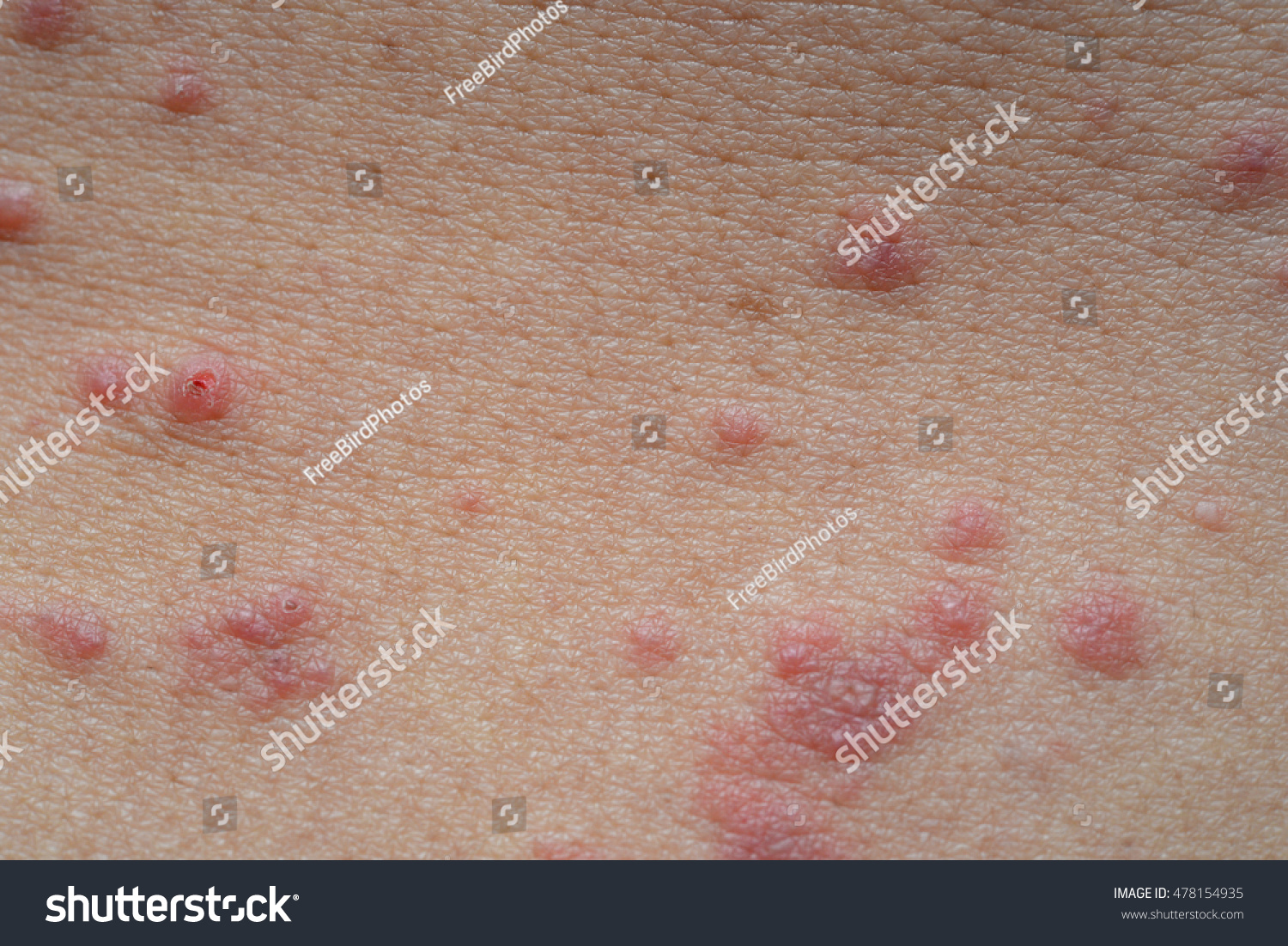 Atopic Dermatitis Symptom Skin Detail Texture Foto Stok 478154935