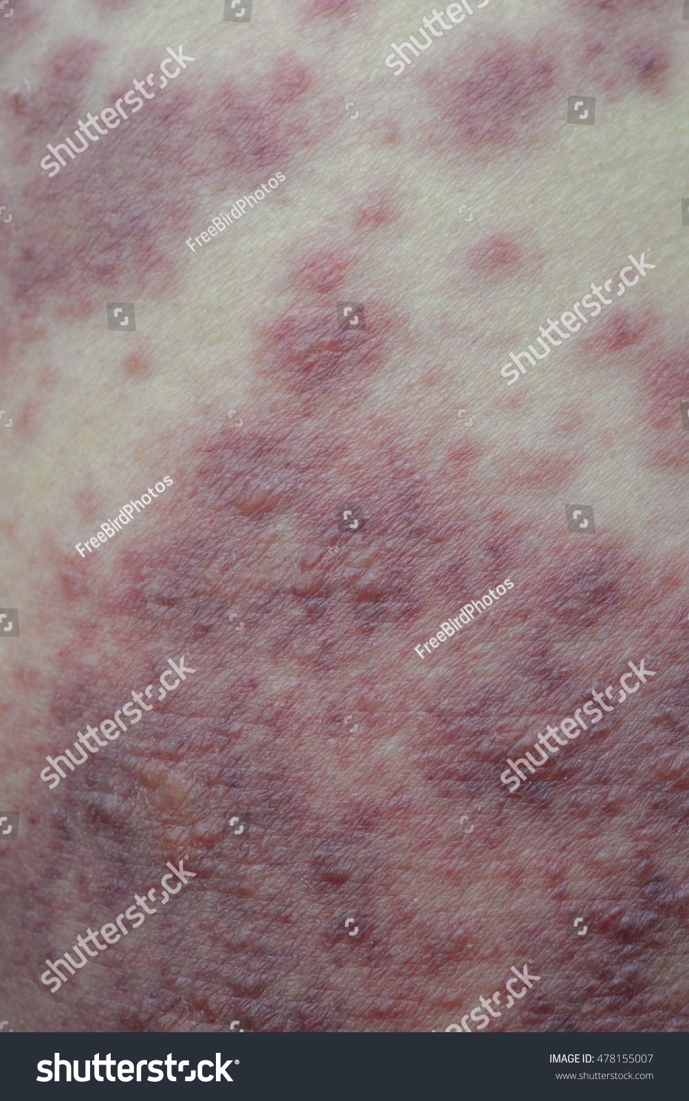 Atopic Dermatitis Symptom Skin Detail Texture 스톡 사진 478155007