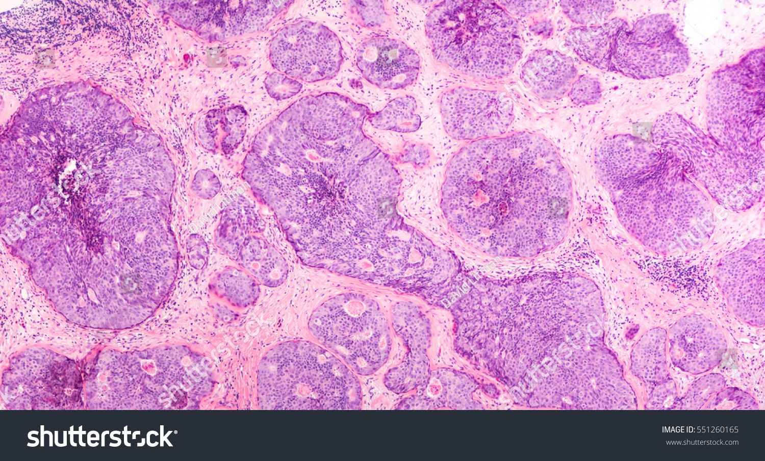 Breast Cancer Core Biopsy Ductal Carcinoma Stock Photo (Edit Now) 551260165 Breast Cancer Core Biopsy Ductal Carcinoma Stock Photo (Edit Now) 551260165