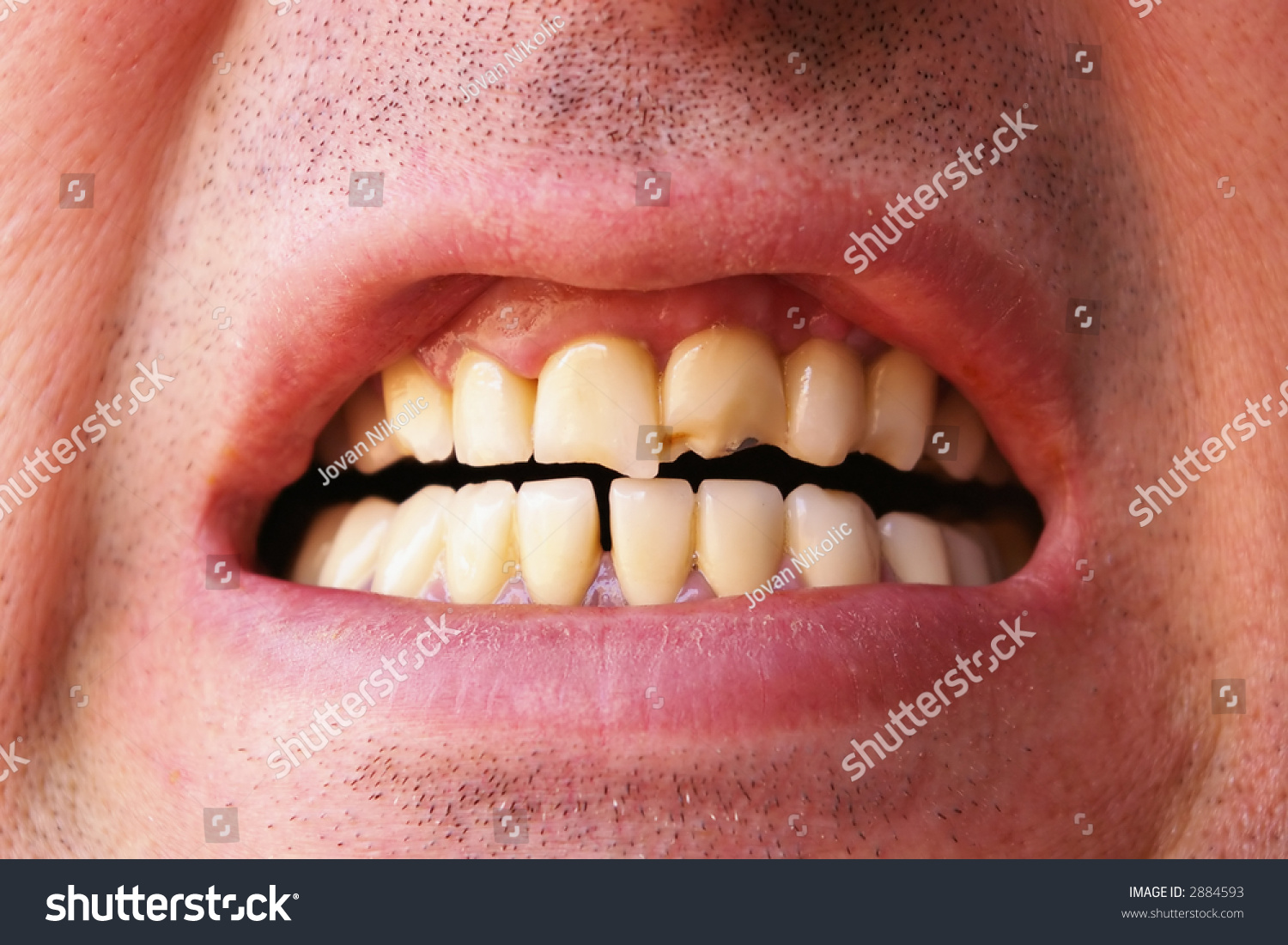 Broken Teeth Stock Photo 2884593 | Shutterstock