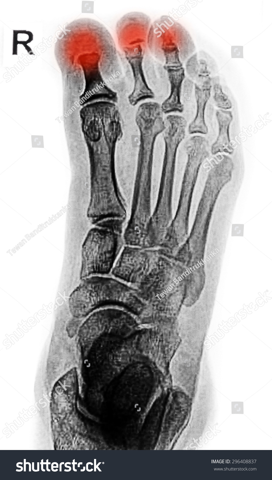 Broken Toe Stock Photo 296408837 | Shutterstock