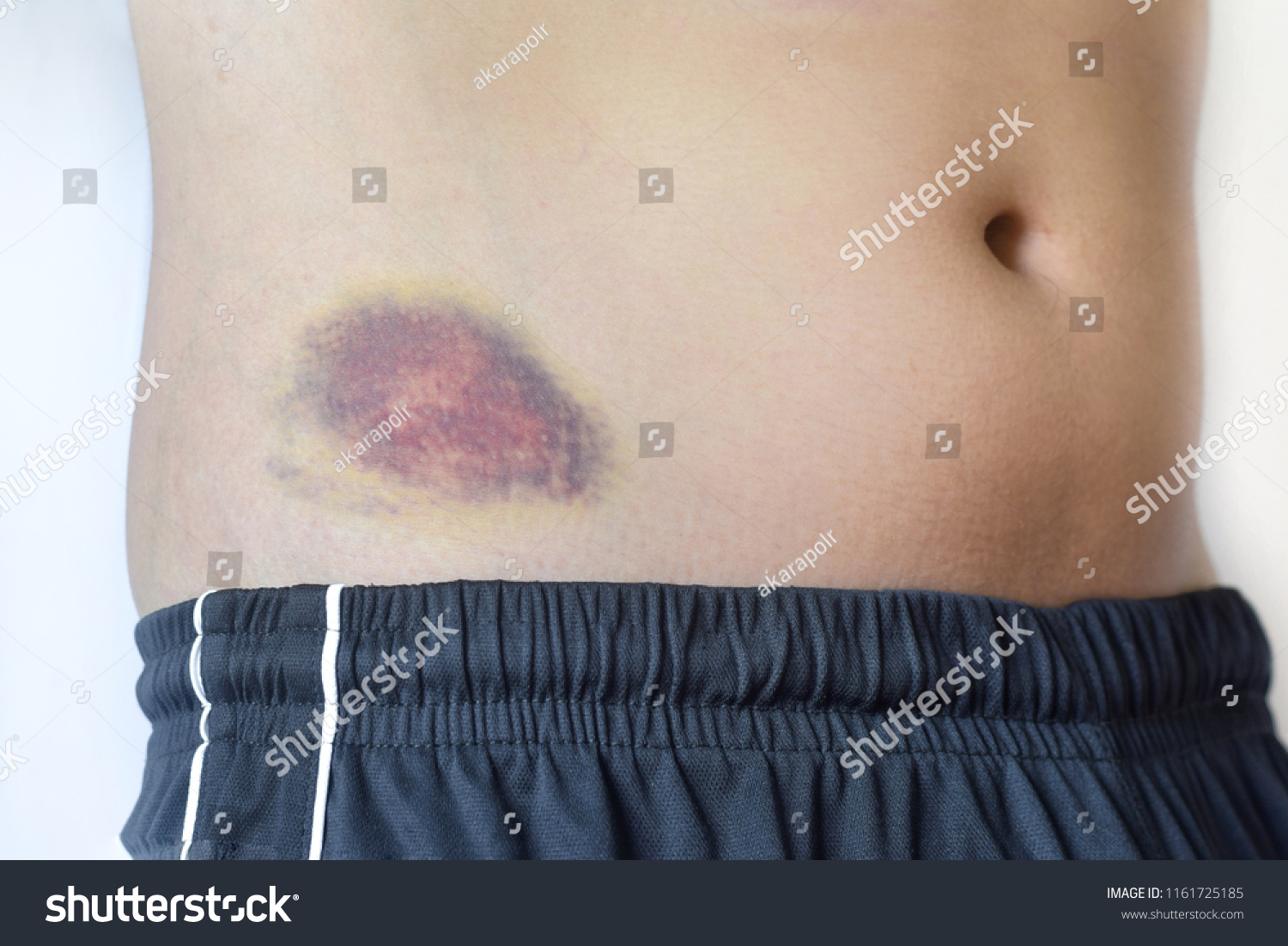 848 Imágenes De Bruise On Stomach Imágenes Fotos Y Vectores De Stock Shutterstock