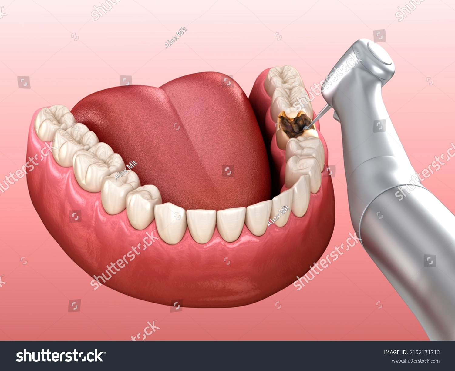 Caries Removing Process Dental 3d Illustration Stock Illustration ... Caries Removing Process Dental 3d Illustration Stock Illustration ...