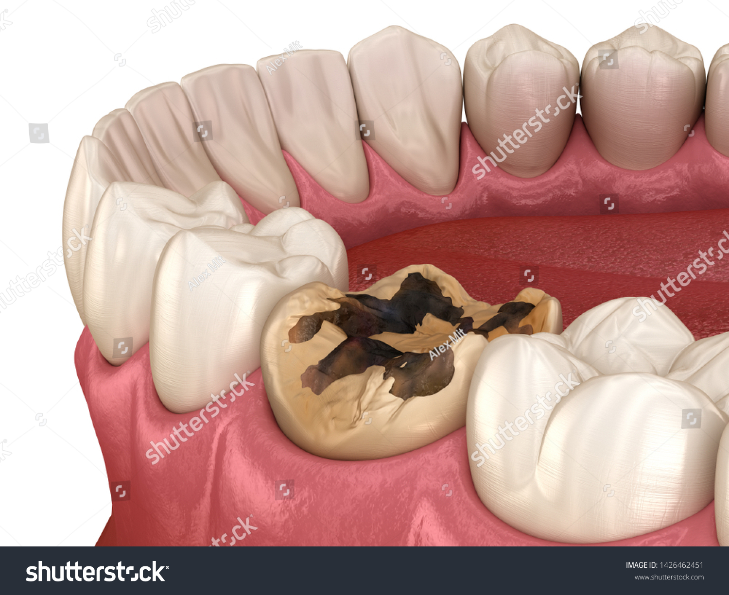 Caries Removing Process Medically Accurate Tooth Stock Illustration ... Caries Removing Process Medically Accurate Tooth Stock Illustration ...