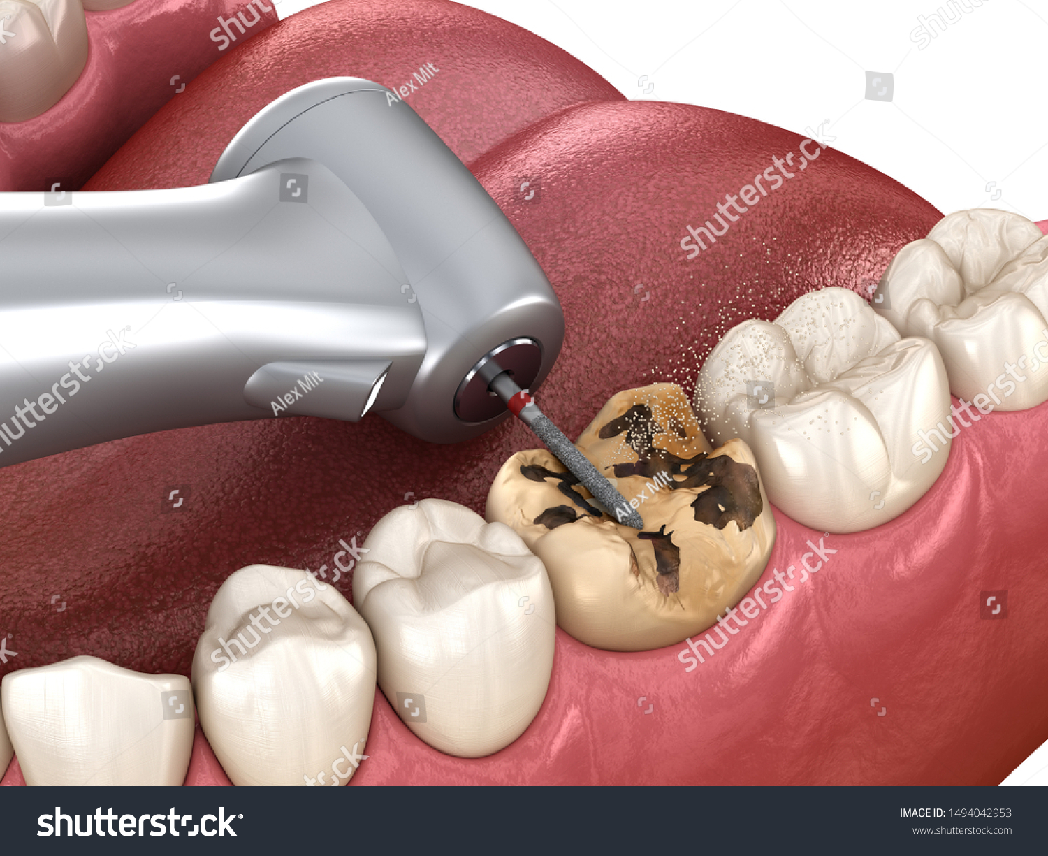 Caries Removing Process Medically Accurate Tooth: ilustrações stock ... Caries Removing Process Medically Accurate Tooth: ilustrações stock ...